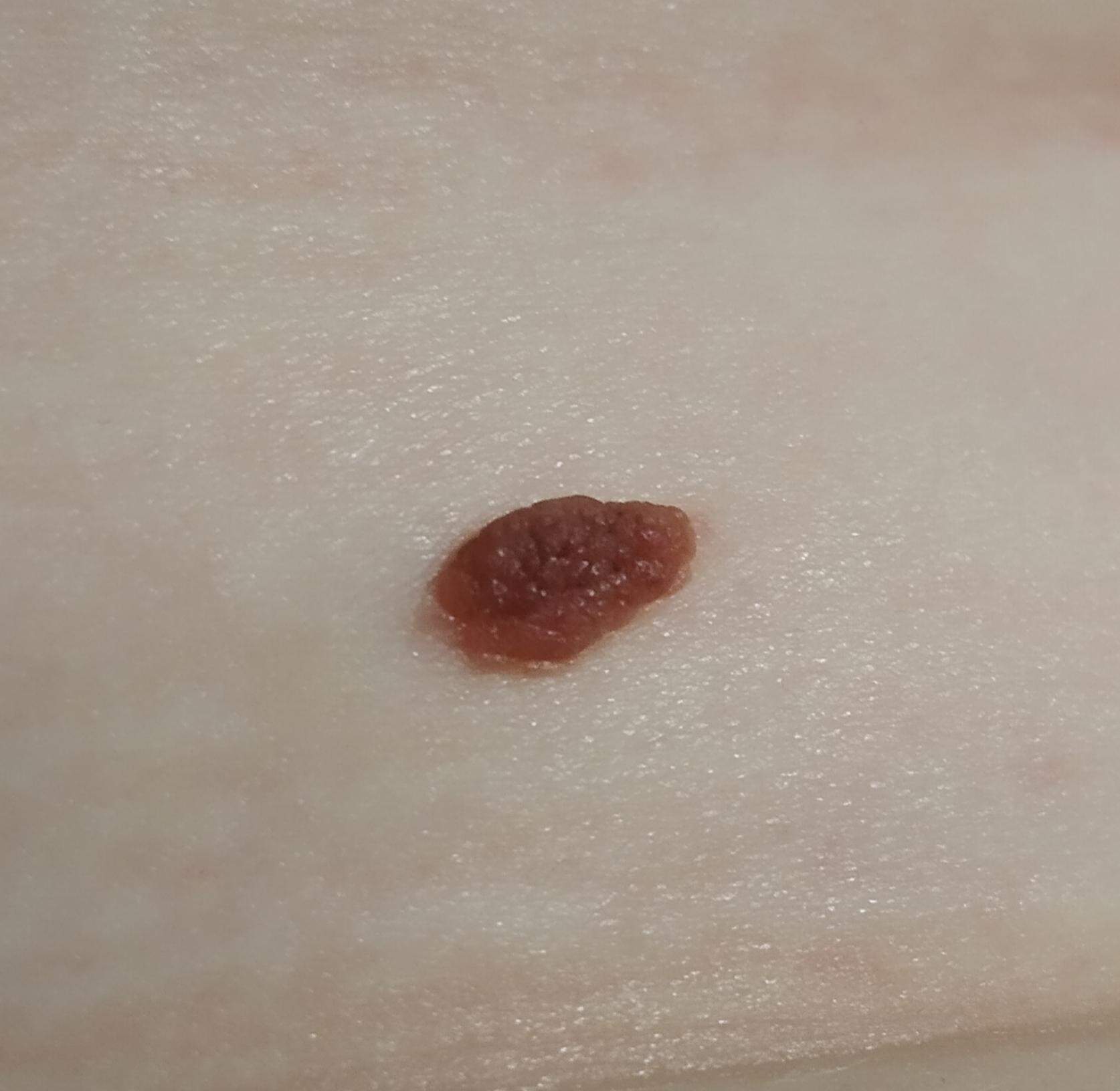 Ist das nur ein Muttermal? (Gesundheit und Medizin, Haut)