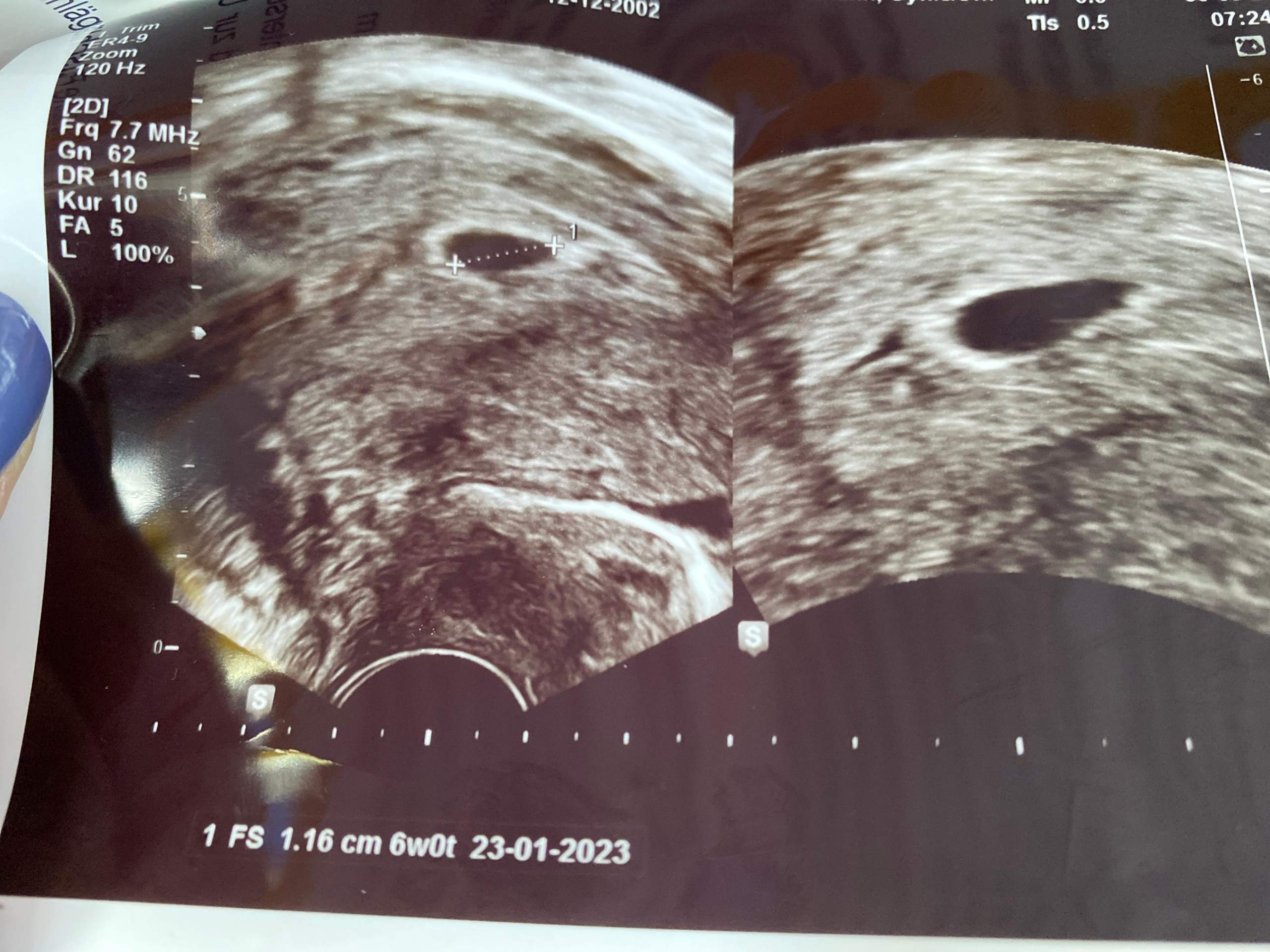 Ist das Ultraschallbild normal für ssw 7? (Schwangerschaft, Ultraschall)