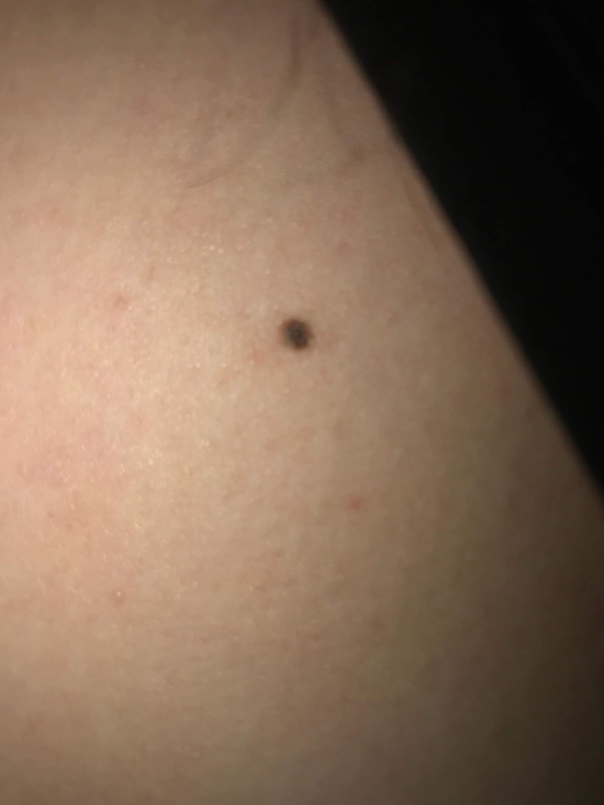 Ist der gesund? (Gesundheit und Medizin, Muttermal)