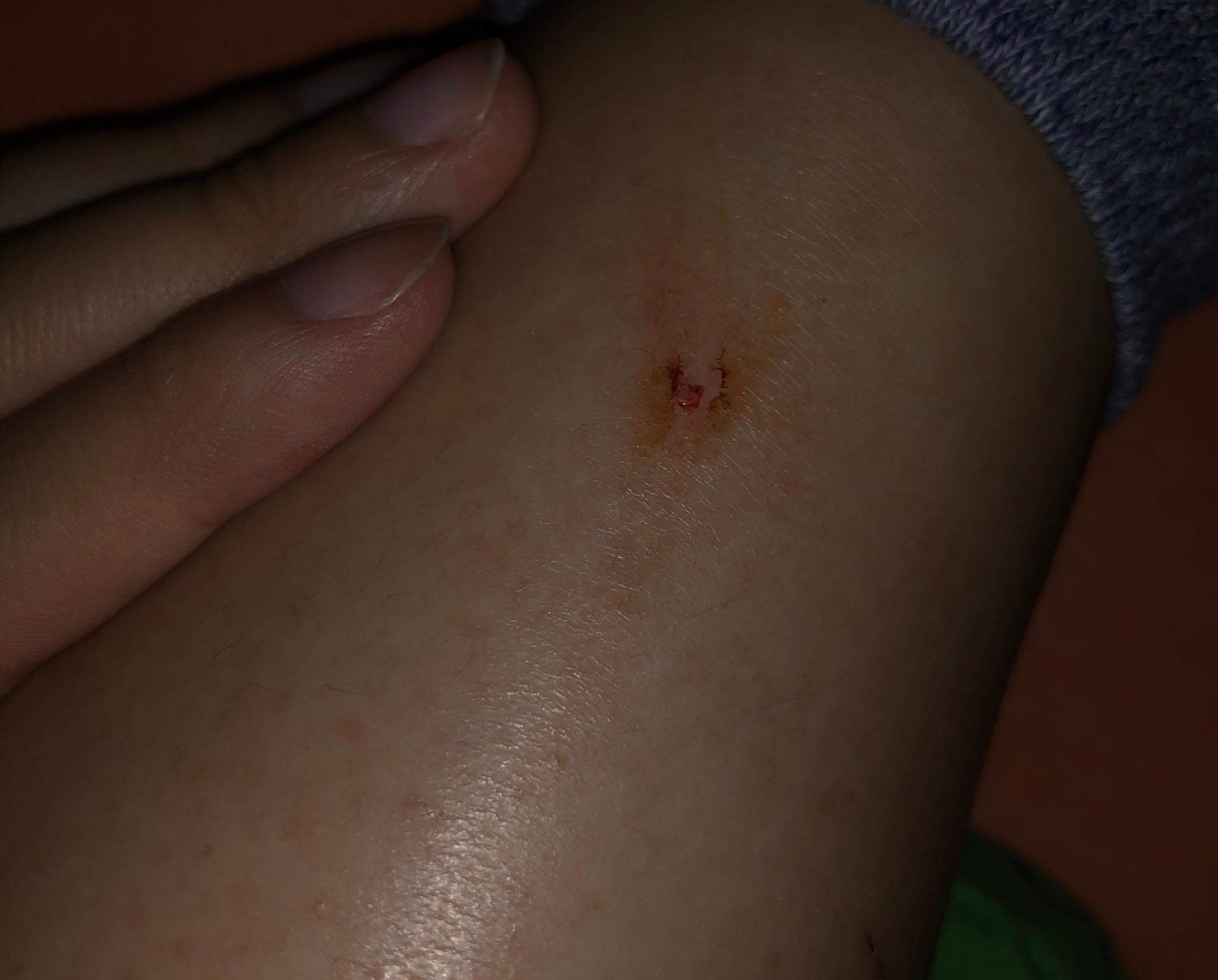 Ist der Katzenbiss schlimm? (Gesundheit und Medizin, Tiere, Katze)