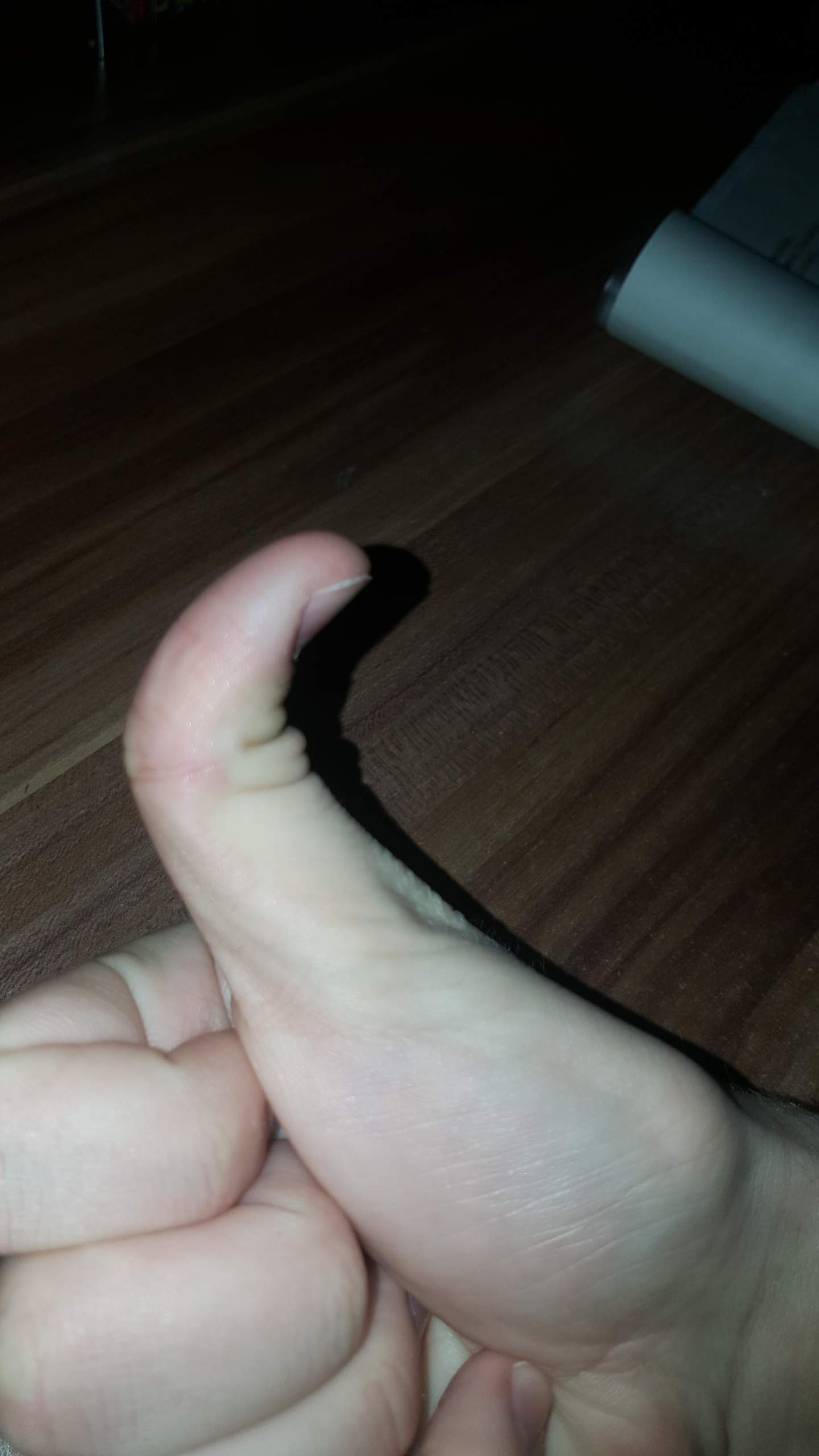 Ist es normal das mein Daumen so aussieht? (Computer, Gesundheit)