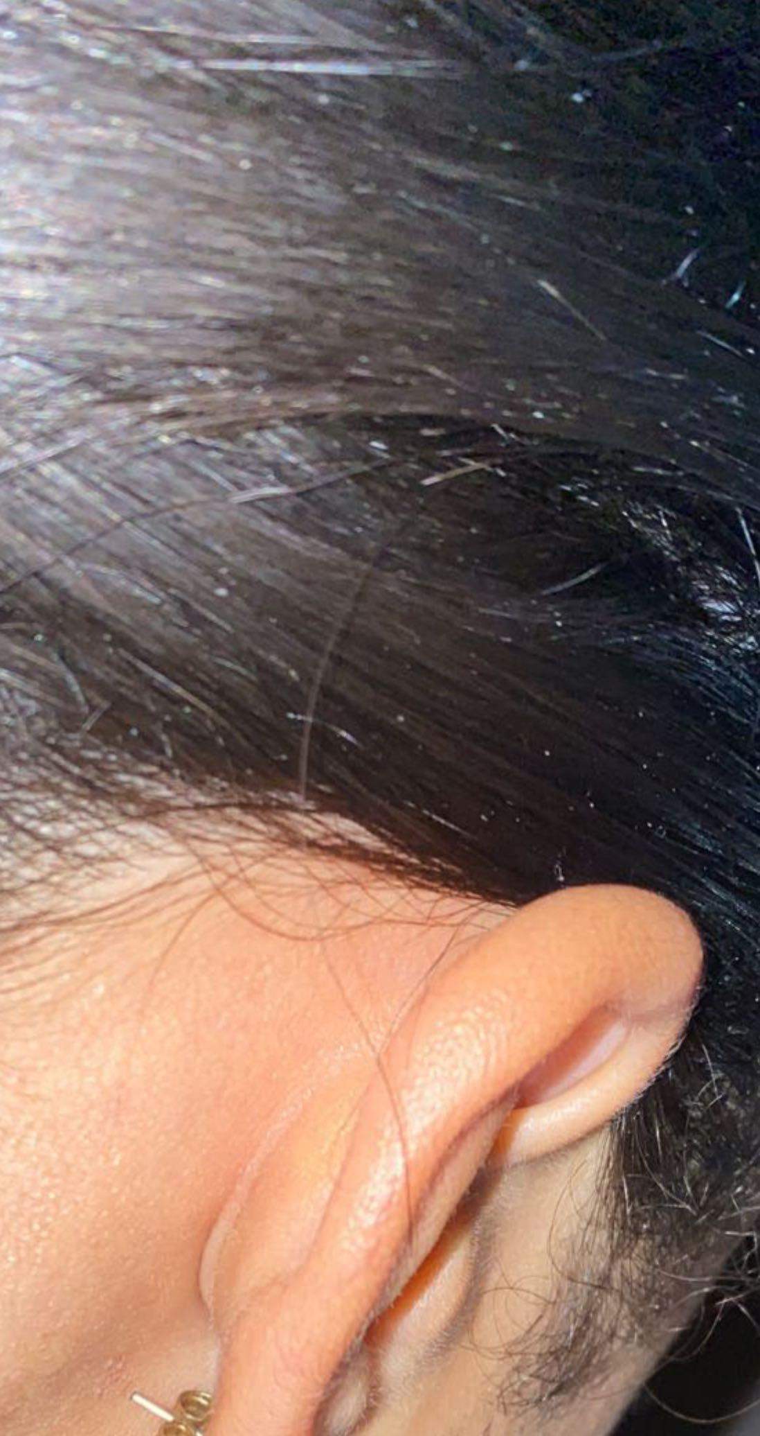 Ist mein Helix entzündet? (Schmerzen, Piercing, Entzündung)