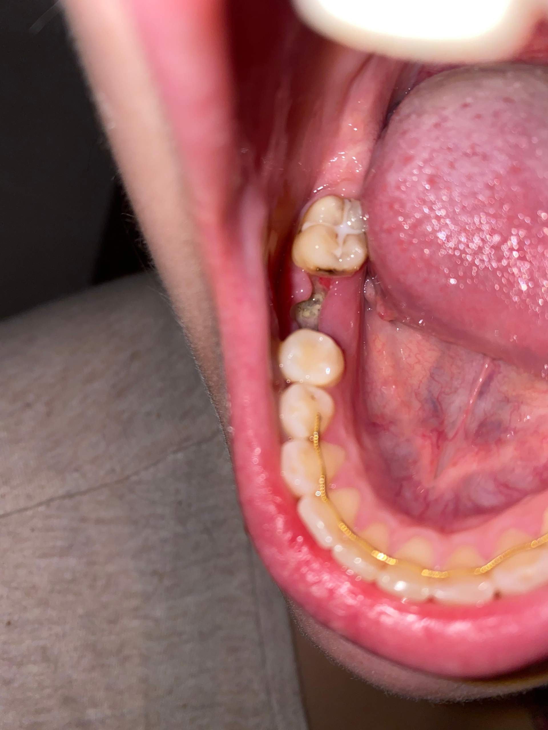 Ist mein Zahnfach entzündet? (Gesundheit und Medizin)