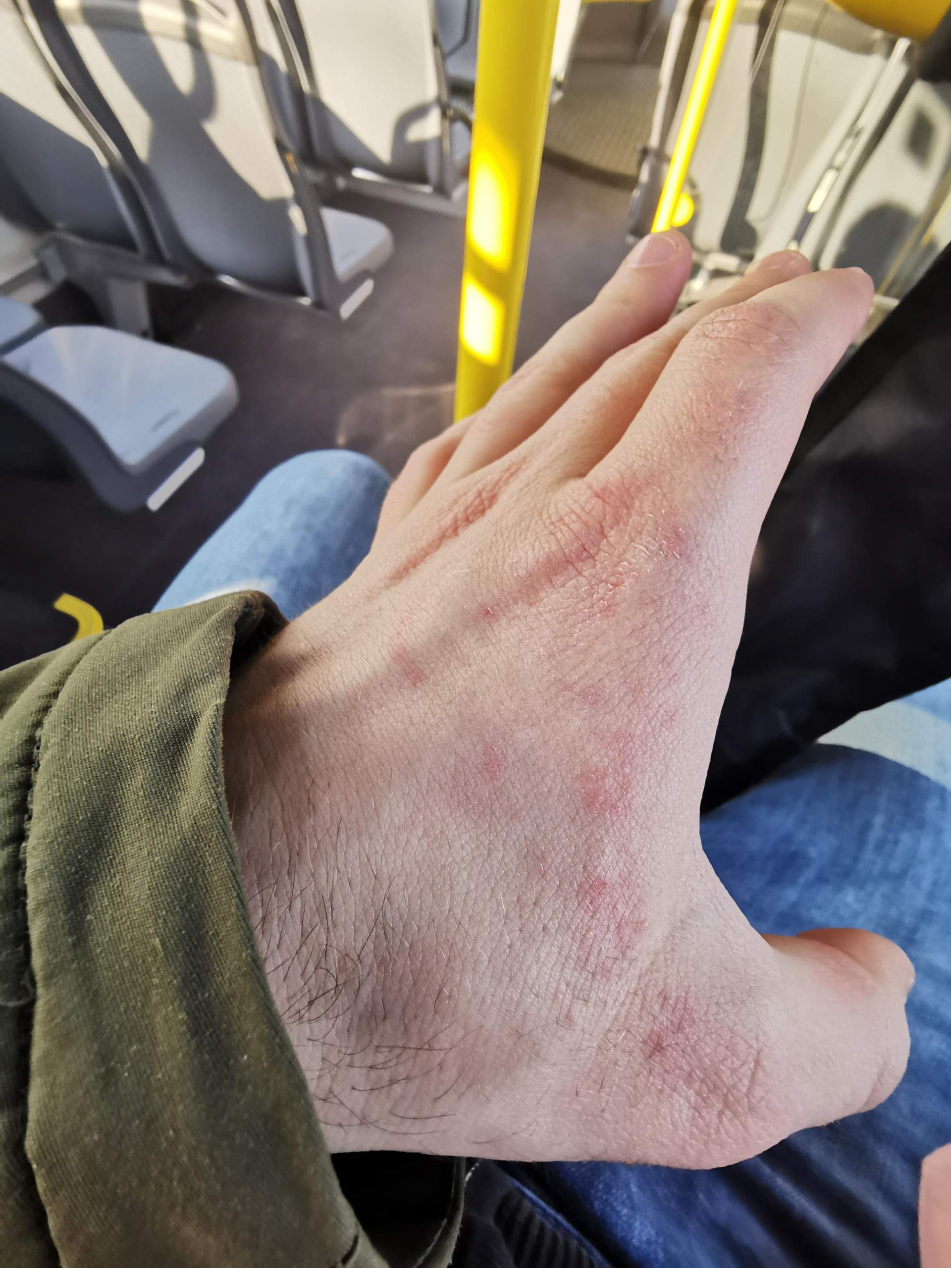 Juckende kleine Pusteln Auf der Haut? (Hautarzt, Hautprobleme)