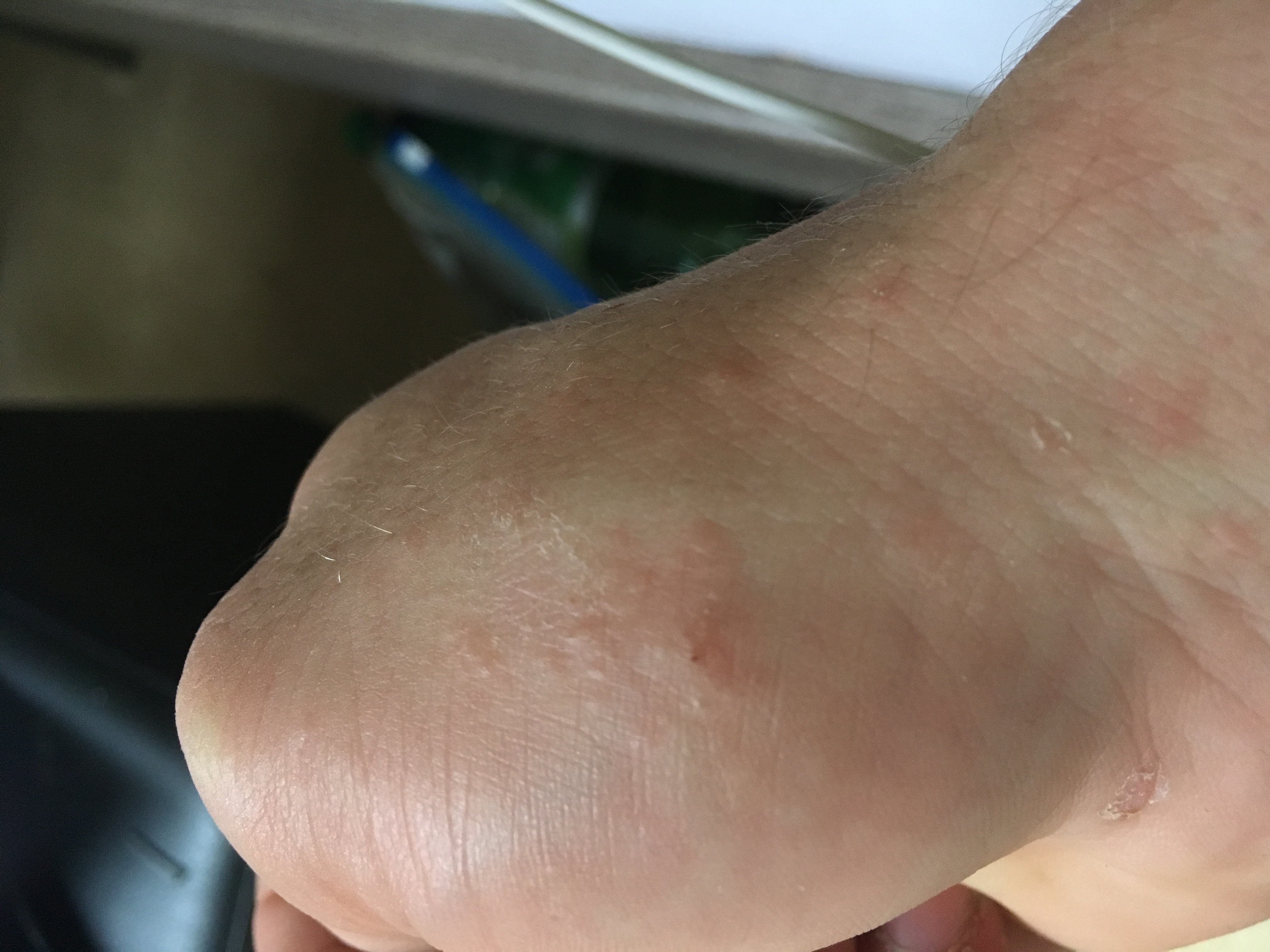 Juckende Pusteln, um was handelt es sich und was kann ich tun? (Körper ...