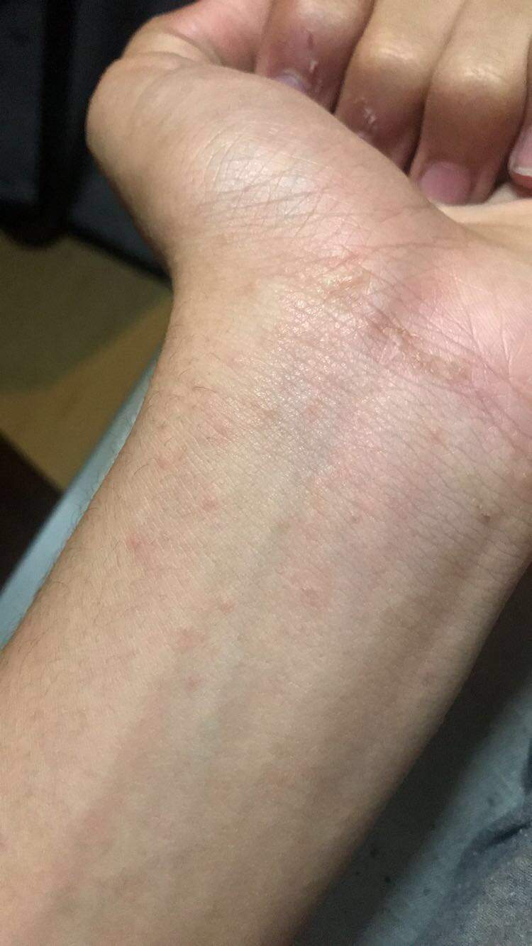 Juckreiz Handgelenk?