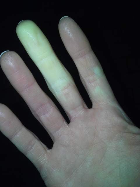 Kalte und taube Finger, vor allem bei kaltem Wetter - jemand eine ...