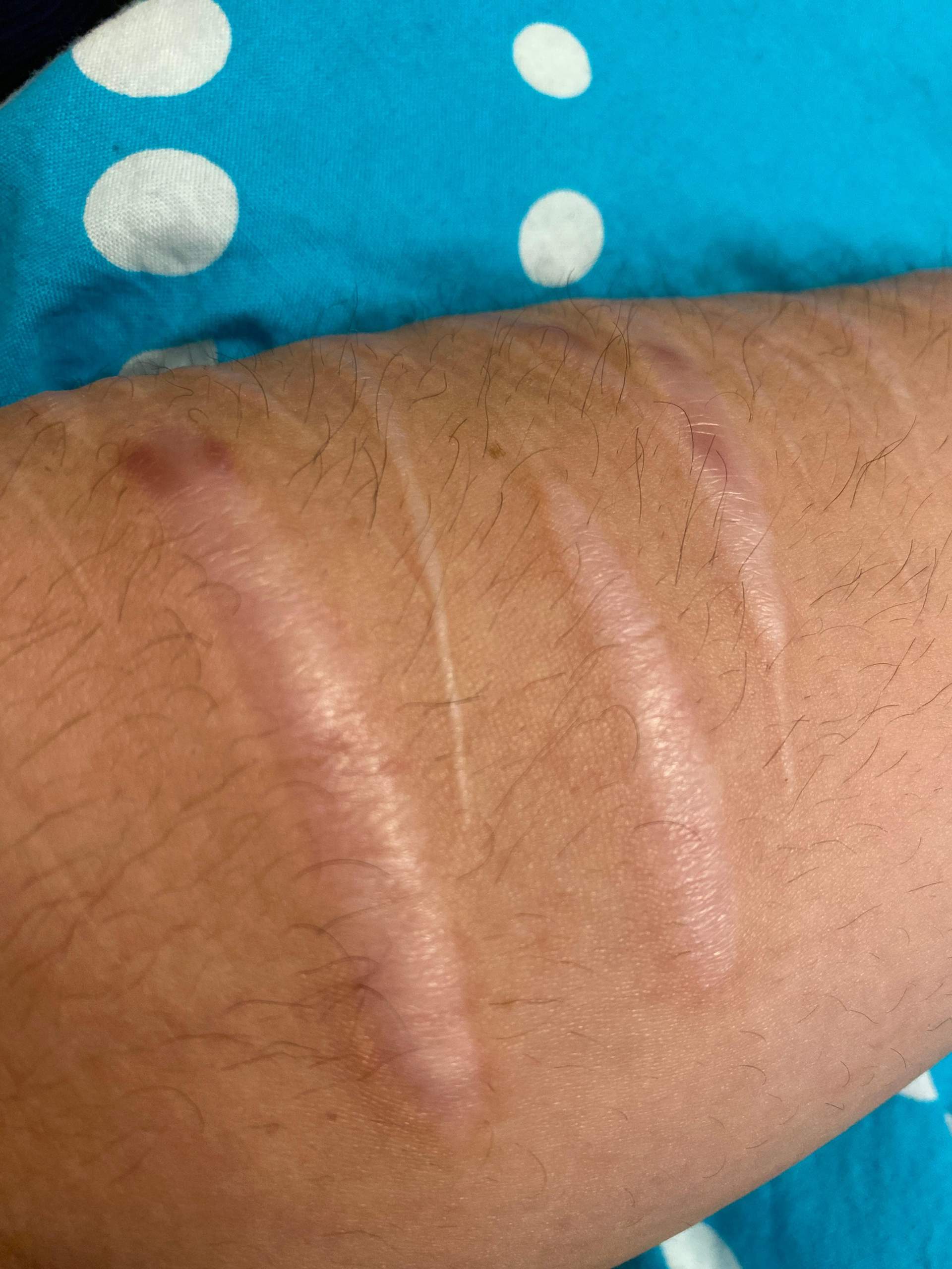 Kann ich auf die narbe ein tattoo machen?...? (Narben)