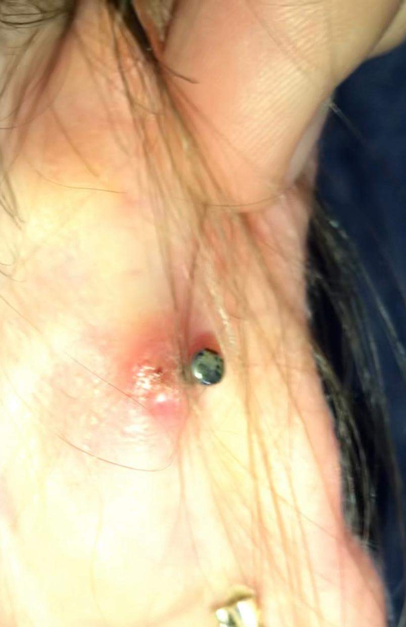 Kann sich das Inner Conch Piercing verschieben? (Piercer ...