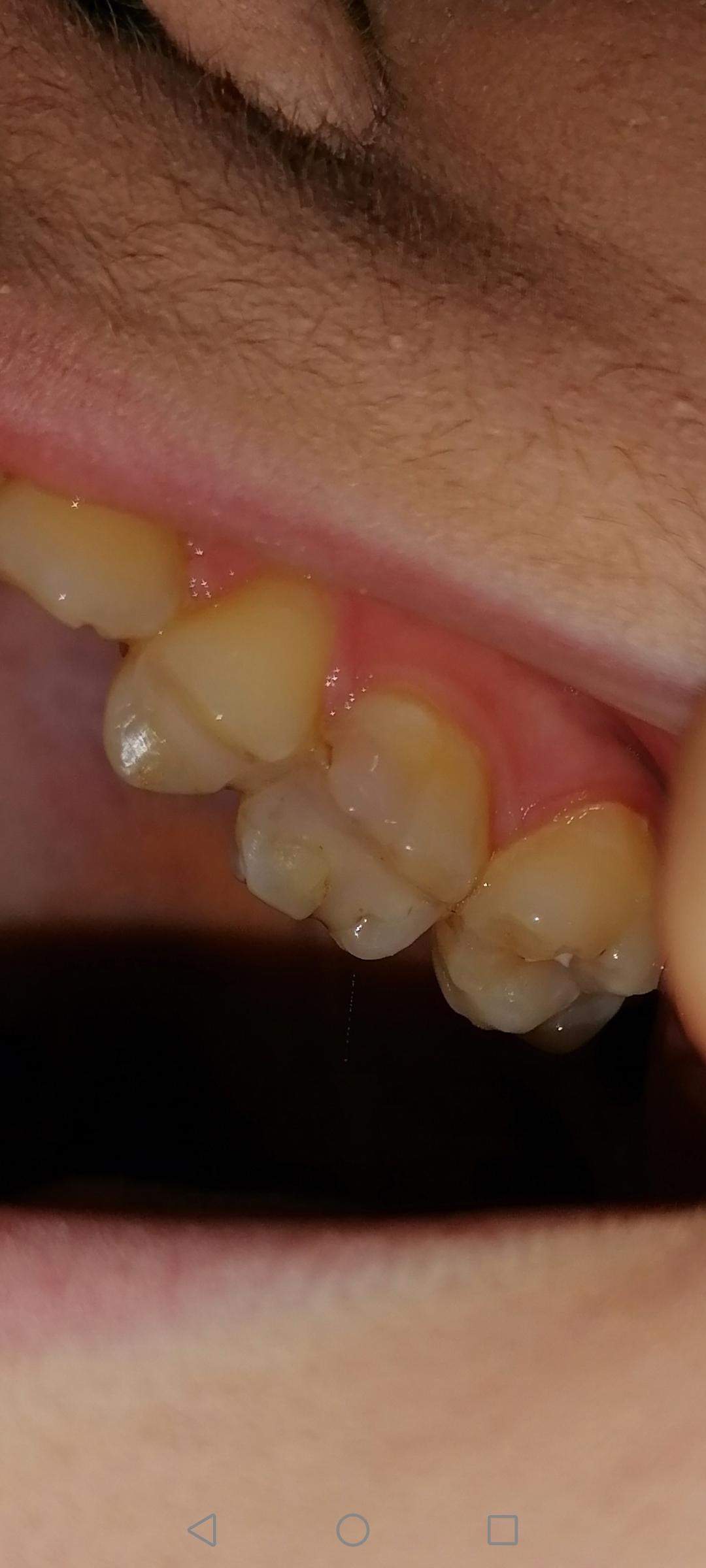 Kaputte Zähne und nun? (Gesundheit und Medizin)