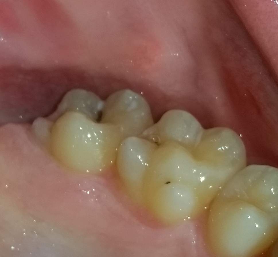 Ich habe bei mir Karies entdeckt. Was kann ich machen? (Gesundheit ...