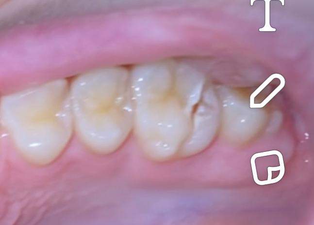 Karies oder Zahnstein? (Gesundheit und Medizin, Zähne, Zahnbehandlung)