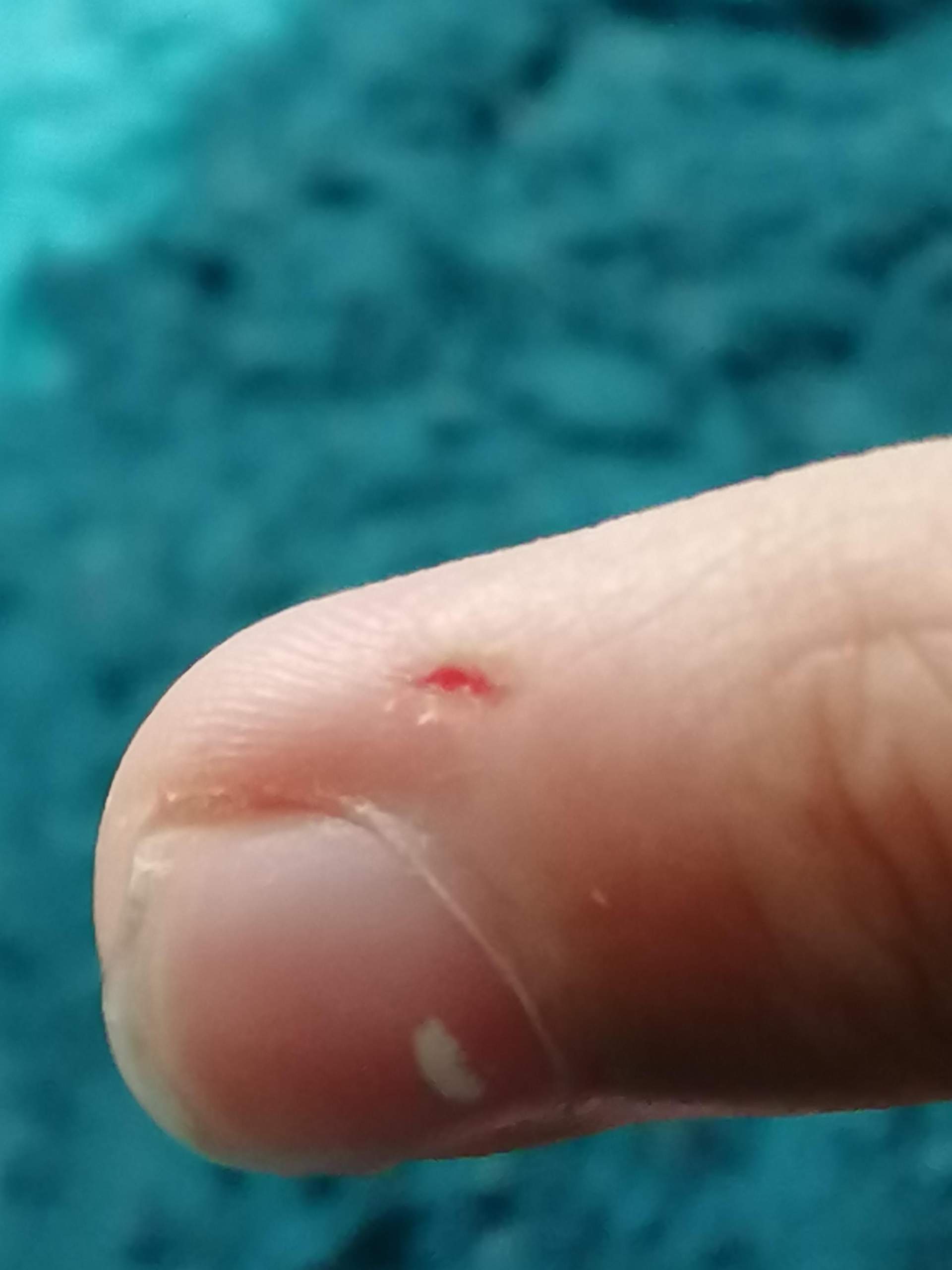 Katzenbiss, gefährlich? Was tun? (Gesundheit und Medizin, Gesundheit ...