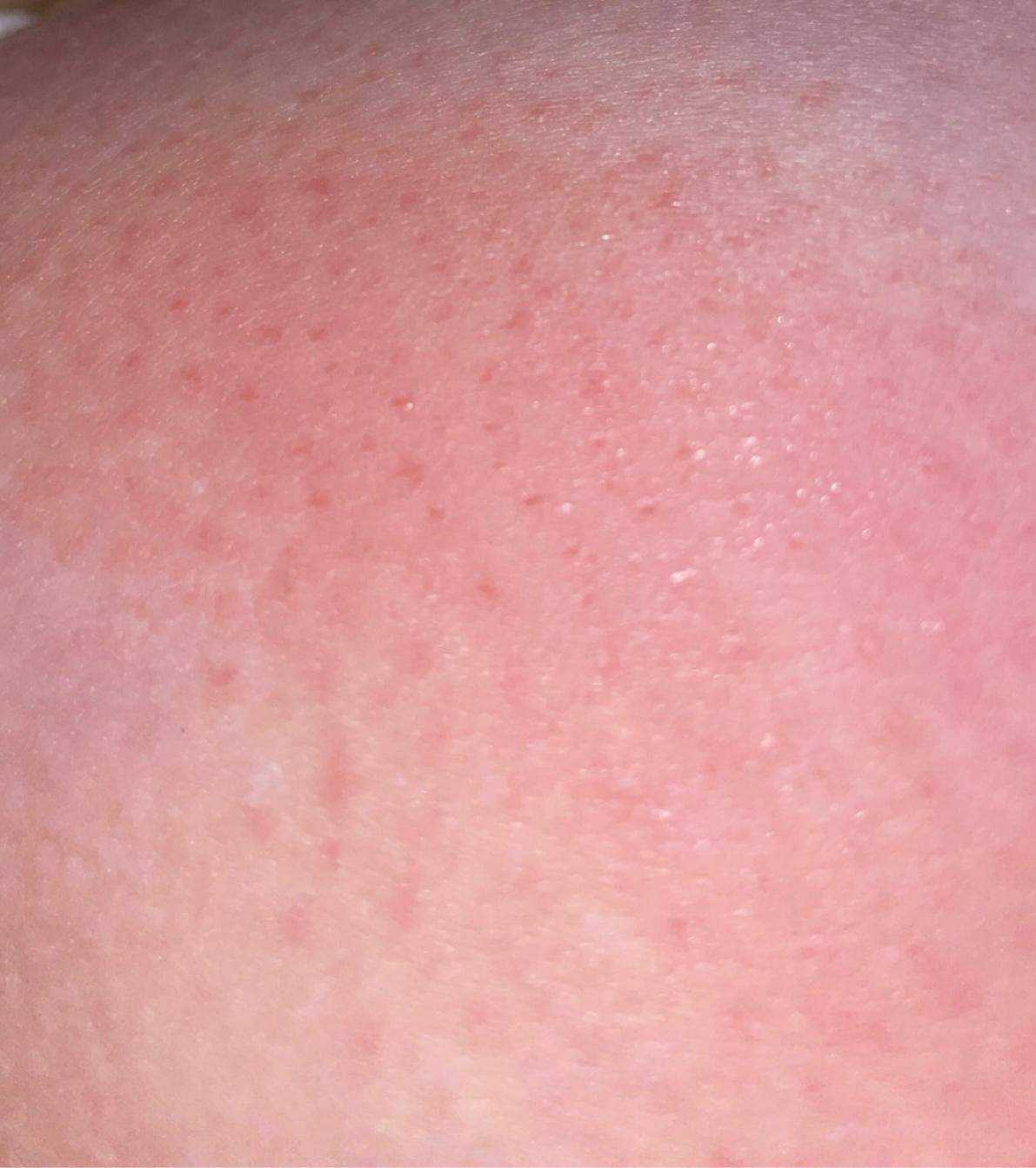 Kleine bisse nach dem baden im see, was ist das? (Gesundheit und ...