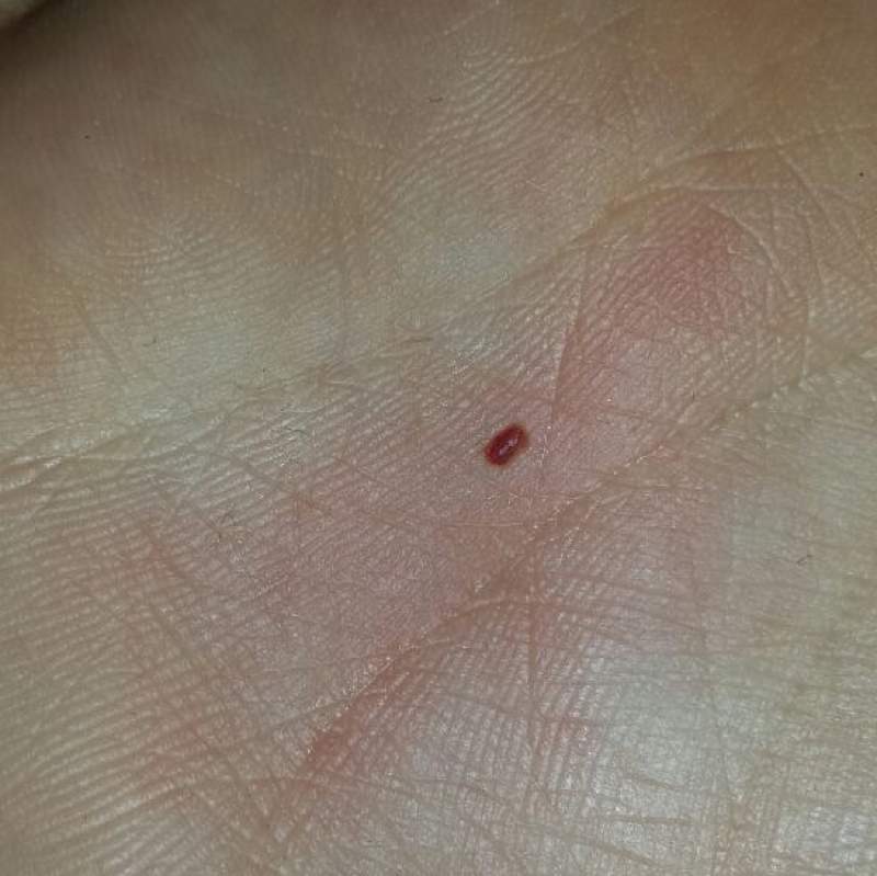 Kleiner roter Punkt unter der Haut (mit Bild)? (Schmerzen, Blut)