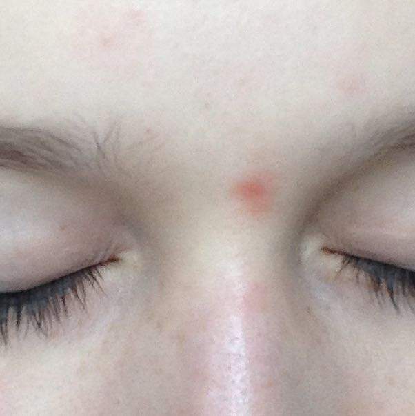 KNALLROTES pickelmal. (Haut, Pickel, Pickelmale)