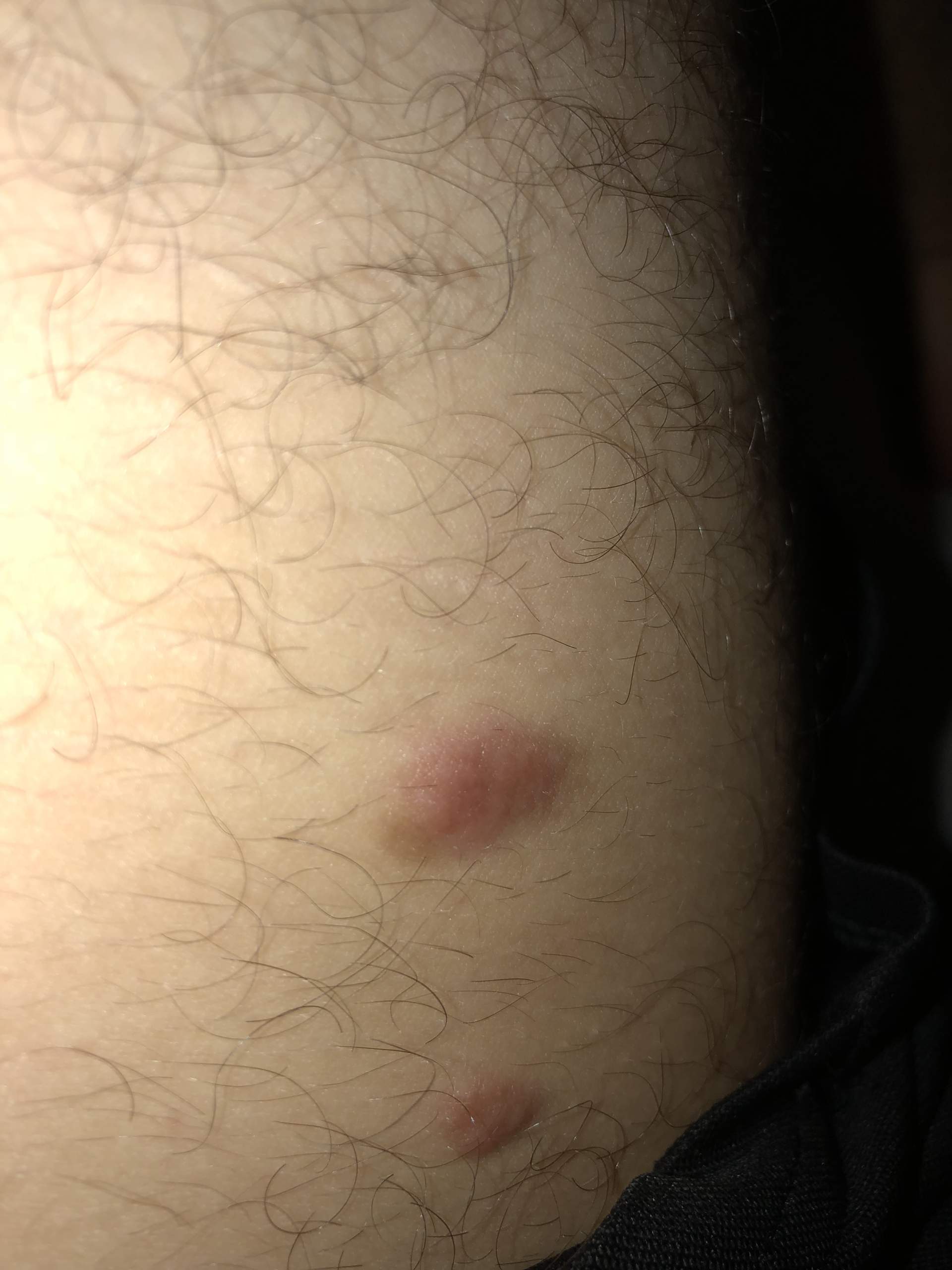 Knoten am Oberschenkel? (Hautprobleme, Abszess, juckende Haut)