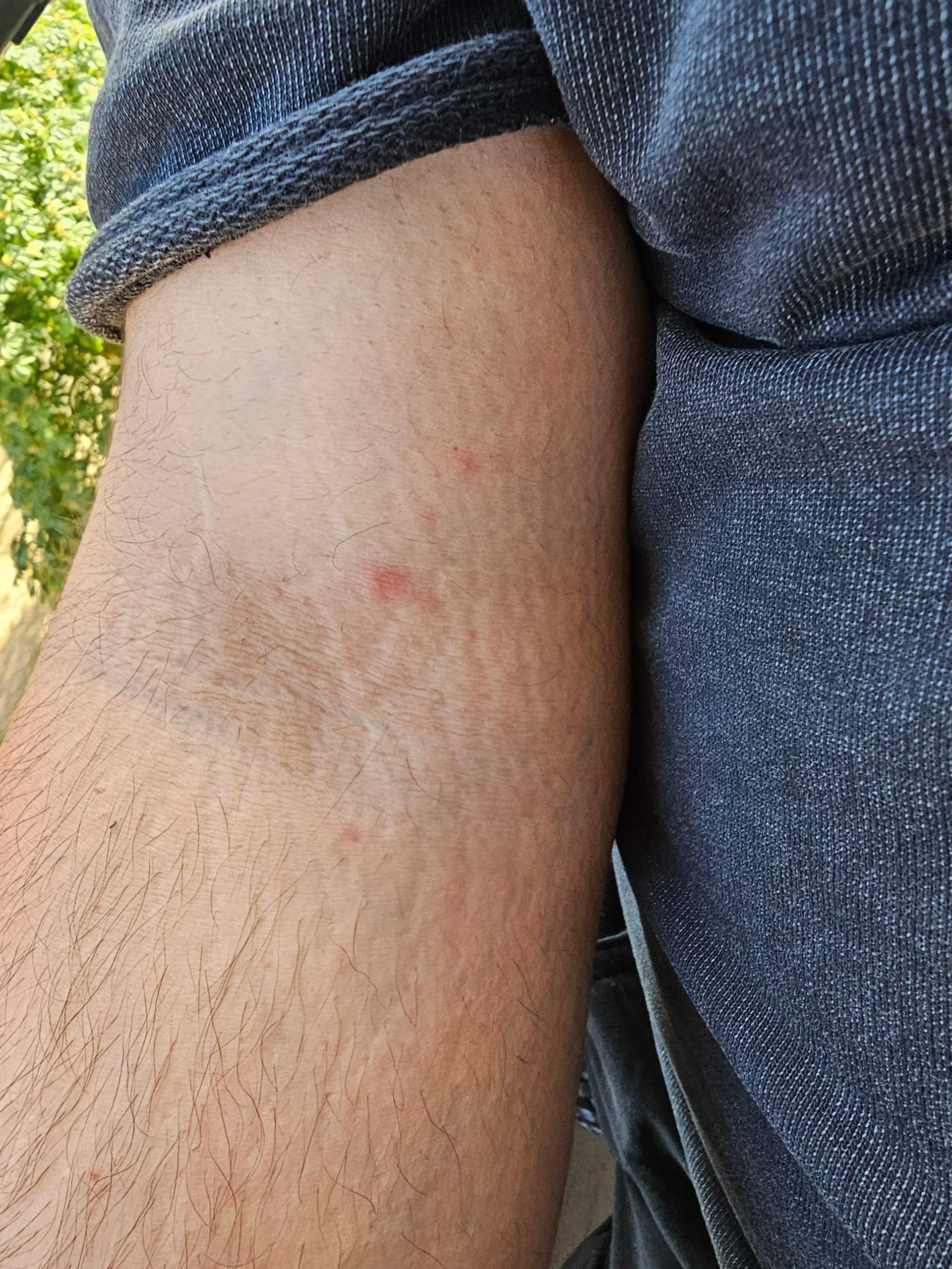 Könnten das Bettwanzen stiche sein? (Schädlinge)