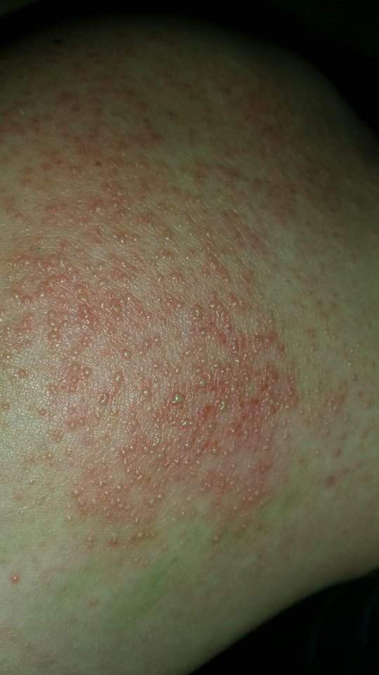 Komische juckende Pusteln (ausschlag) am Knie, weiß jemand was dass ...