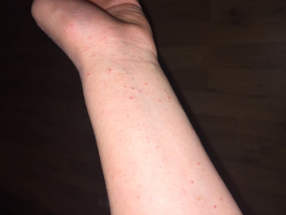 Pusteln - die meistgelesenen Fragen