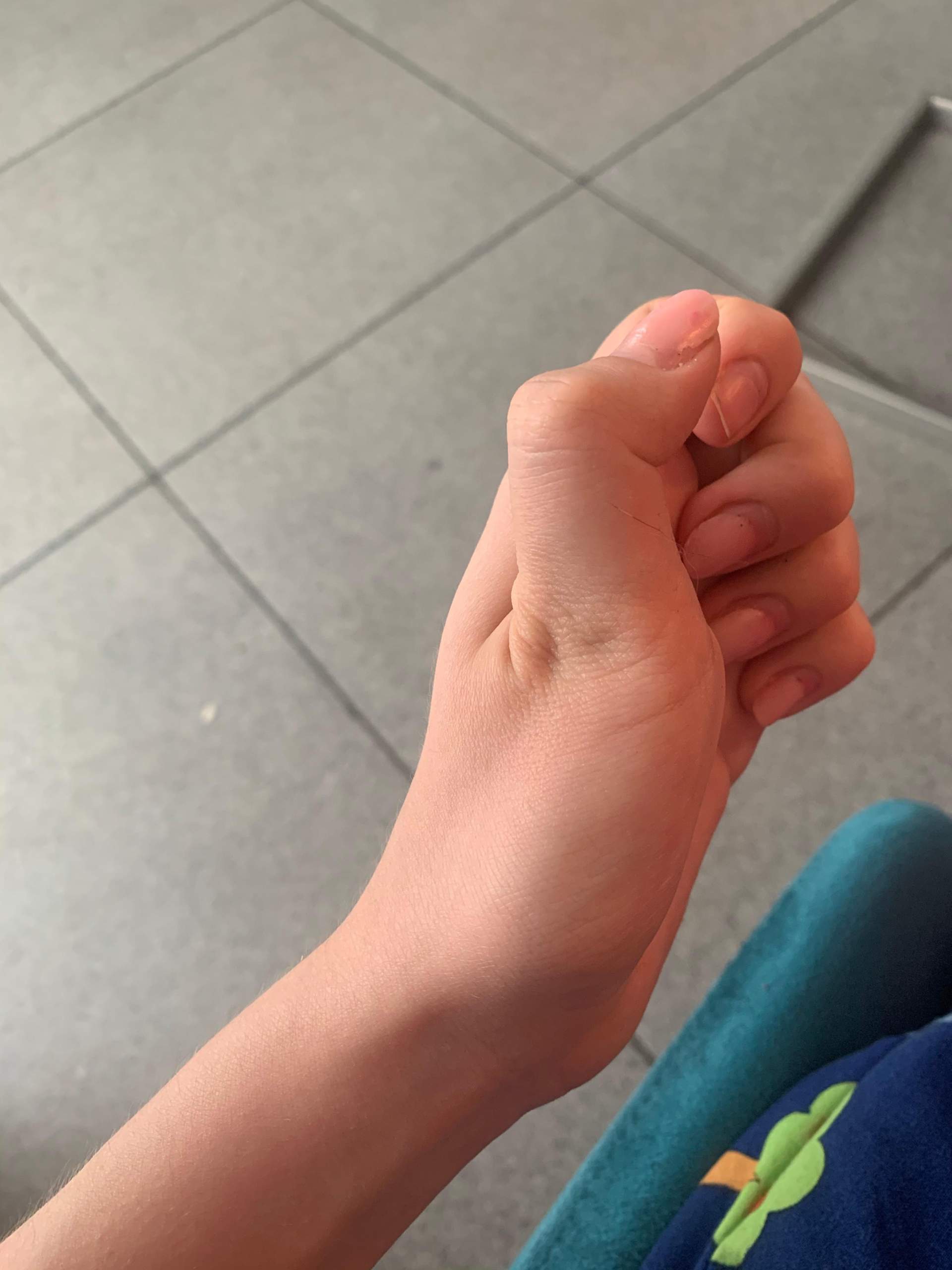 Komischer Daumen? (Gesundheit und Medizin, Gesundheit, Diagnose)