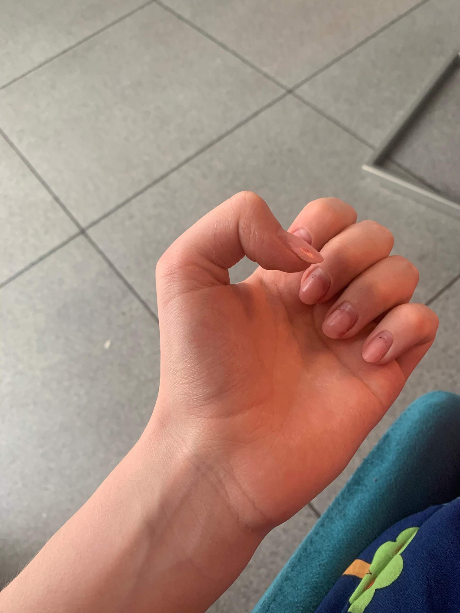 Komischer Daumen? (Gesundheit und Medizin, Gesundheit, Diagnose)