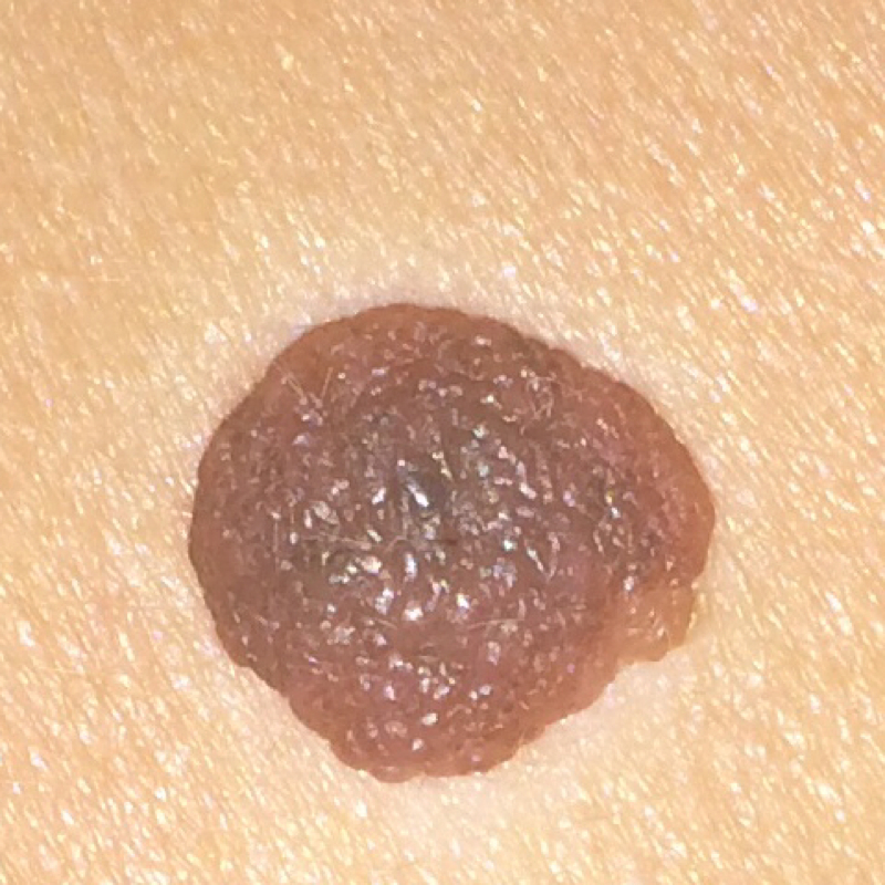 Krebsangst leberfleck (melanom)