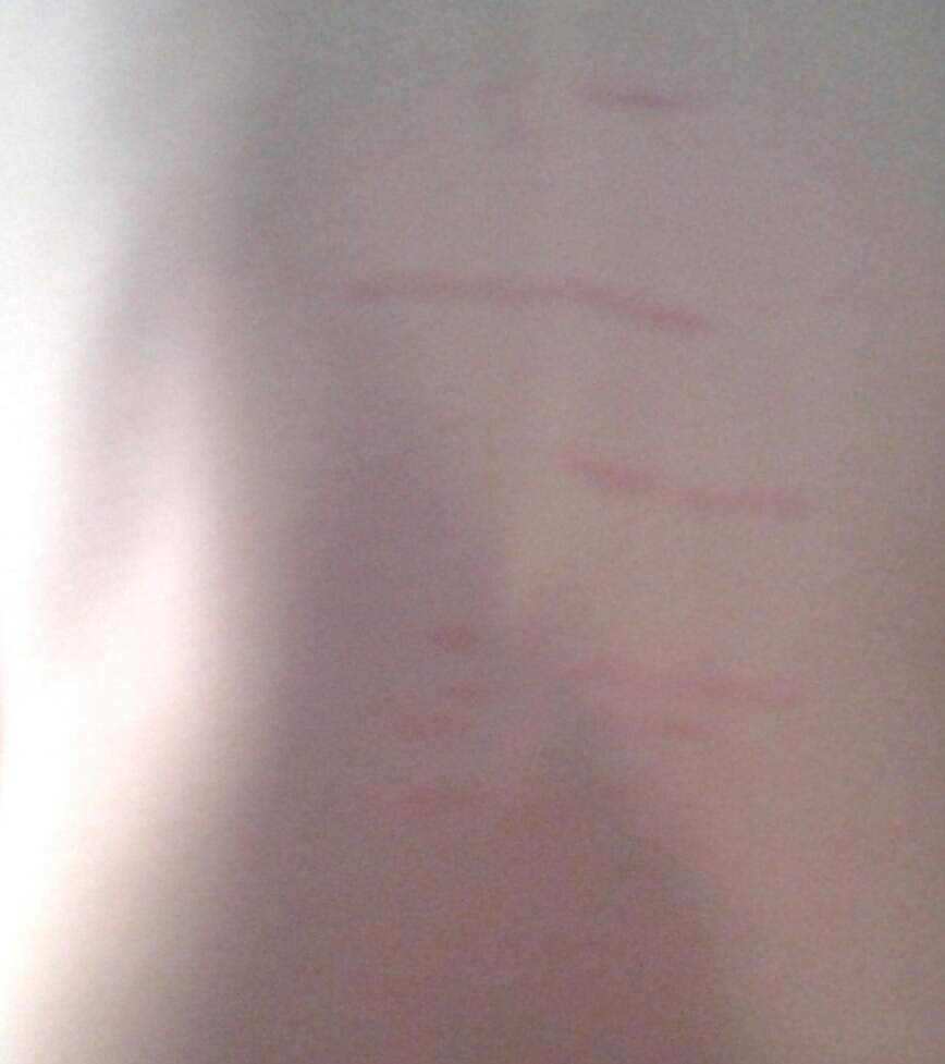 Lange, waagerechte Narben am Rücken