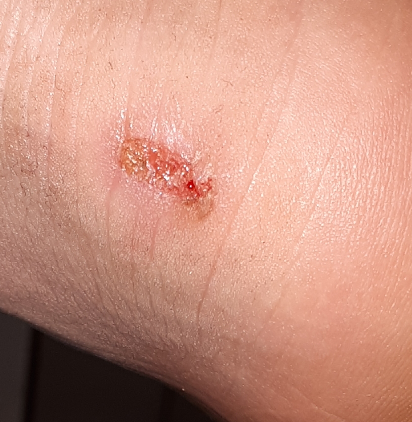 Liegt hier eine Wundinfektion vor? (Gesundheit und Medizin, Verletzung ...