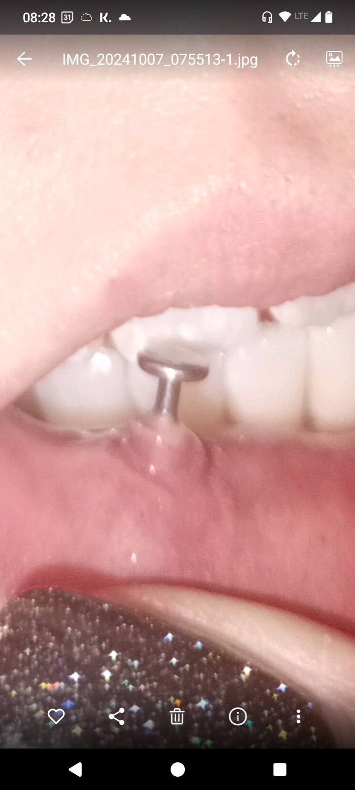 Lippenpiercing Beule durchs draufbeißen beim essen. Geht die Beule auch ...