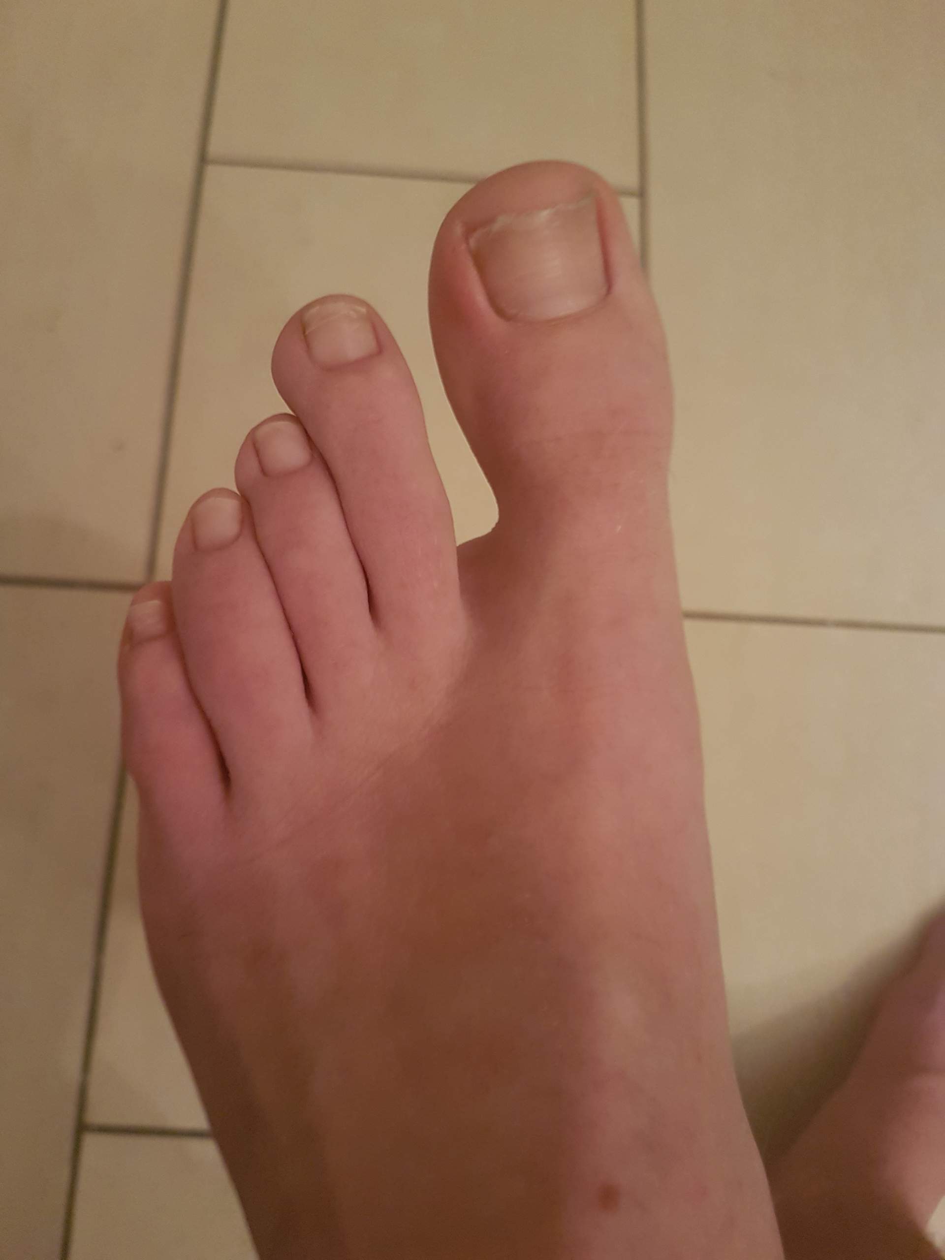 Lücke zwischen 1. Und 2. Zeh normal? (Aussehen, Füße)