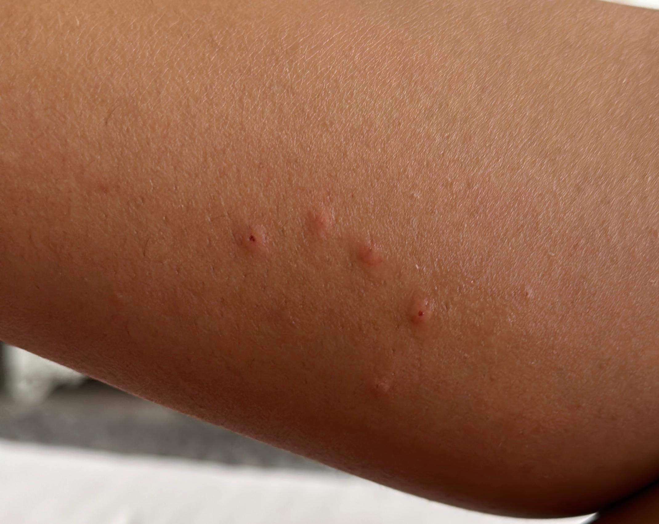 Mehrere Stiche/ Bisse nebeneinander? (Medizin, Insekten, Stich)