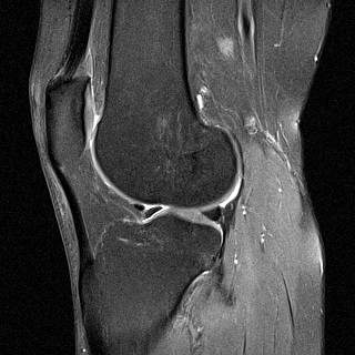 Meniskus in Ordnung? (Knie, Orthopäde, Sportverletzung)
