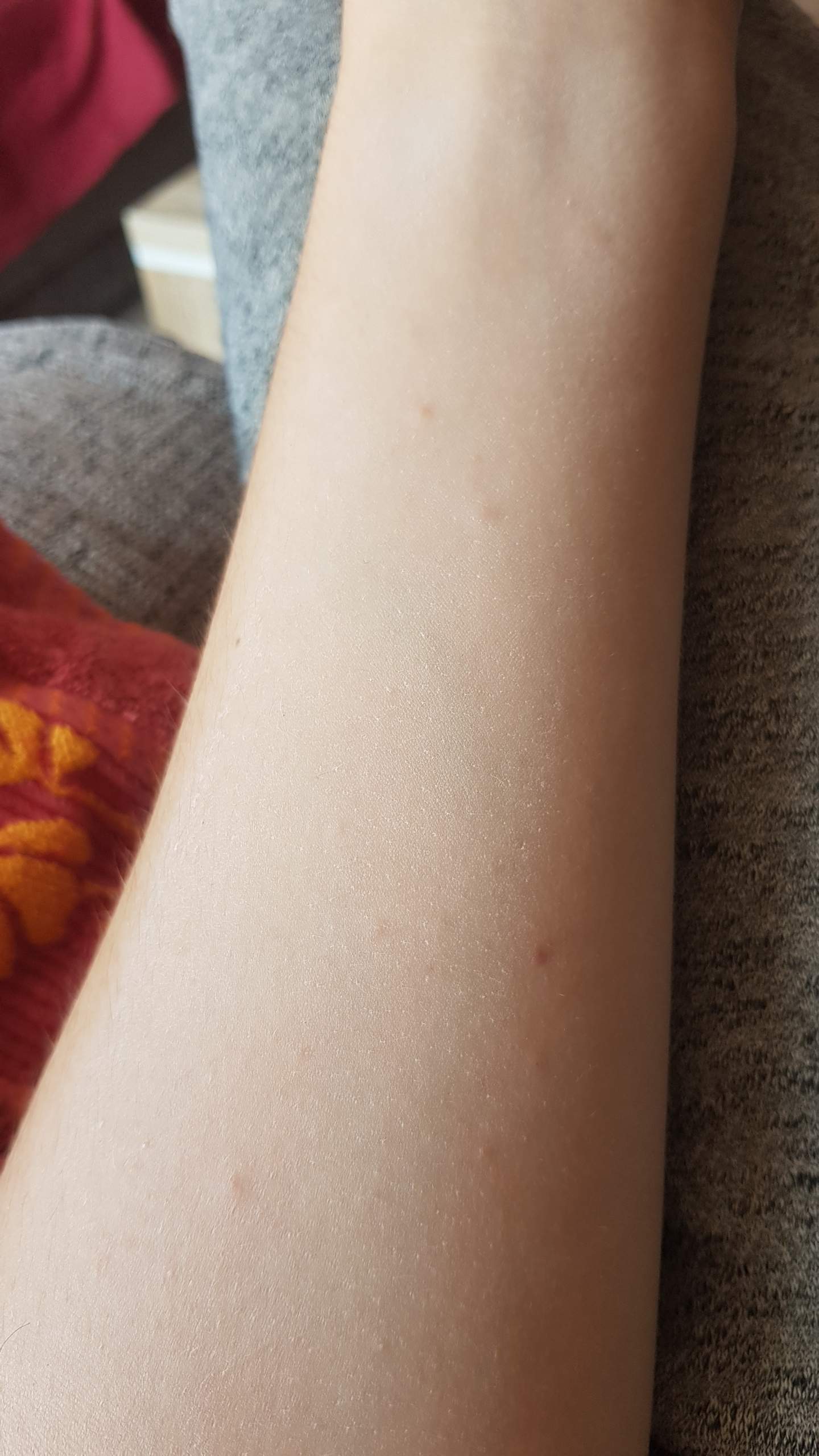 Milben bisse? (Gesundheit und Medizin, Medizin)