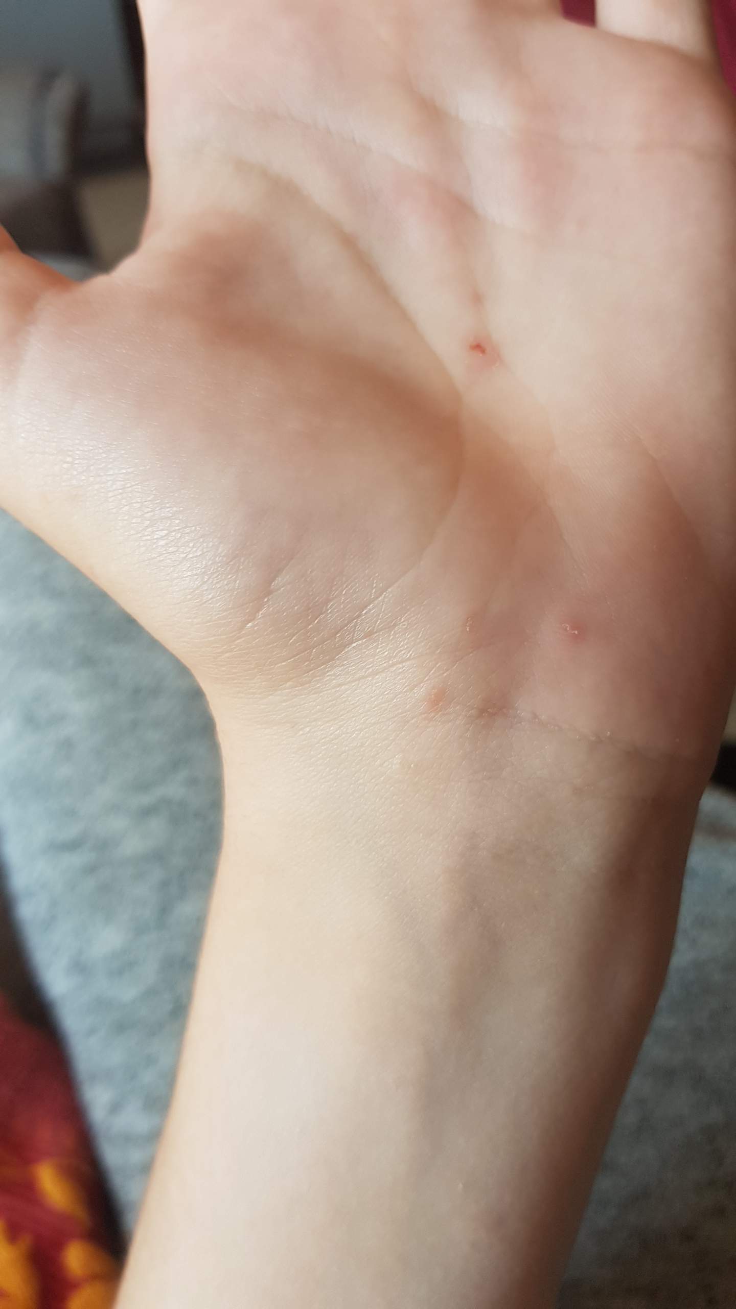 Milben bisse? (Gesundheit und Medizin, Medizin)