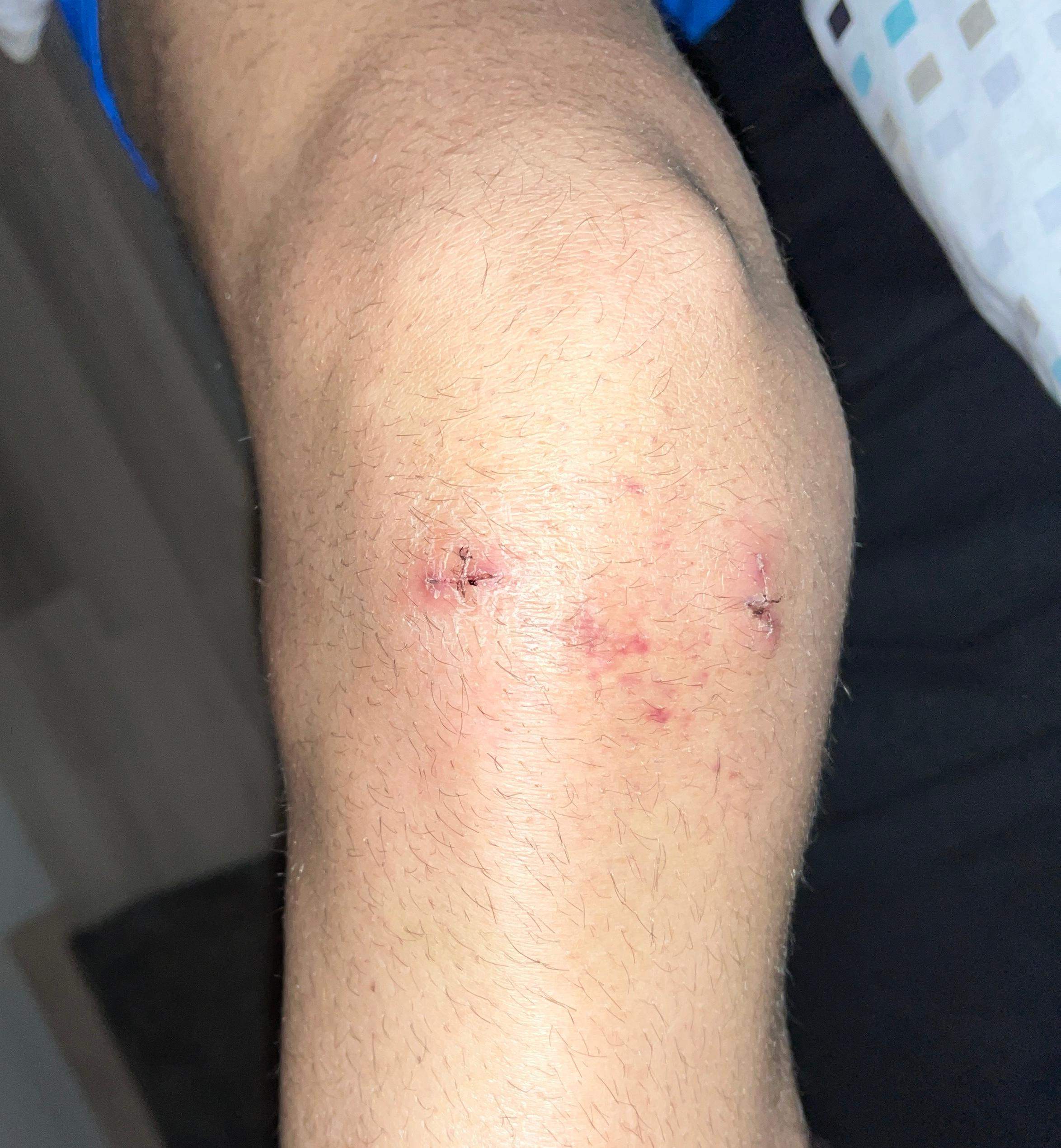 Mit dieser Wunde schwimmen gehen? (Operation, Knie, Schwimmbad)