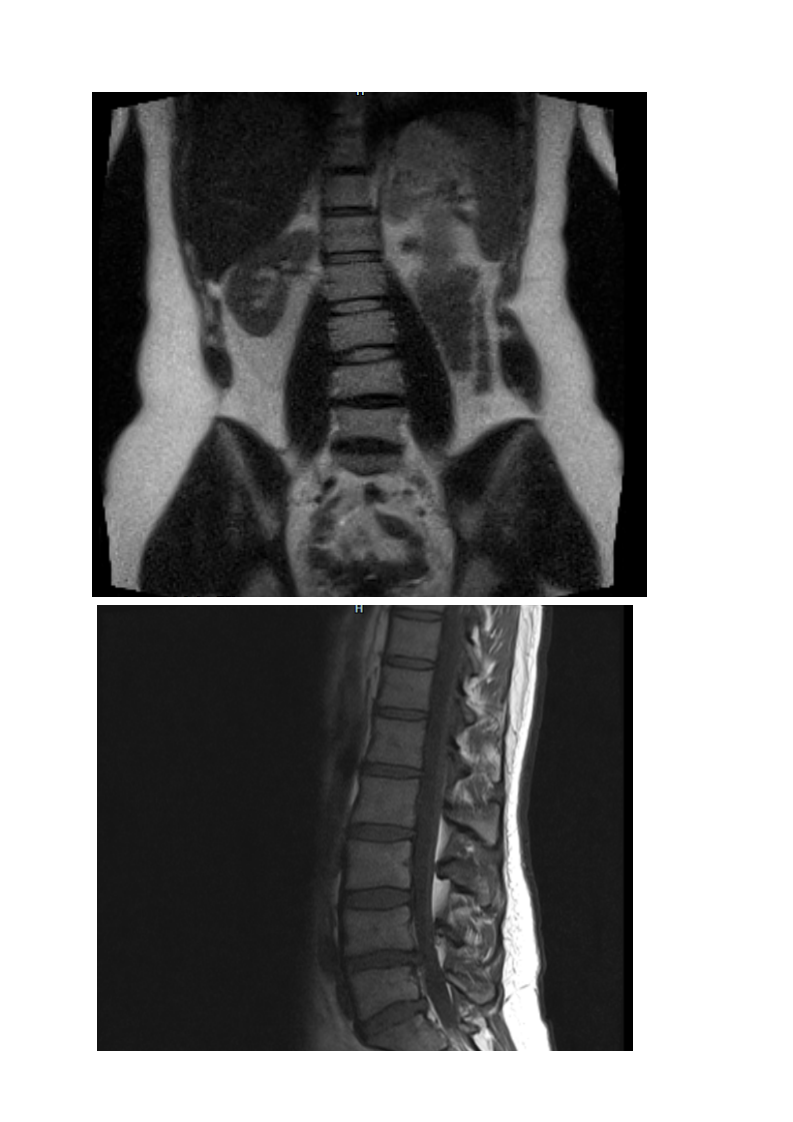 MRT Aufnahme analysieren (Bandscheibenvorfall)? (Medizin ...