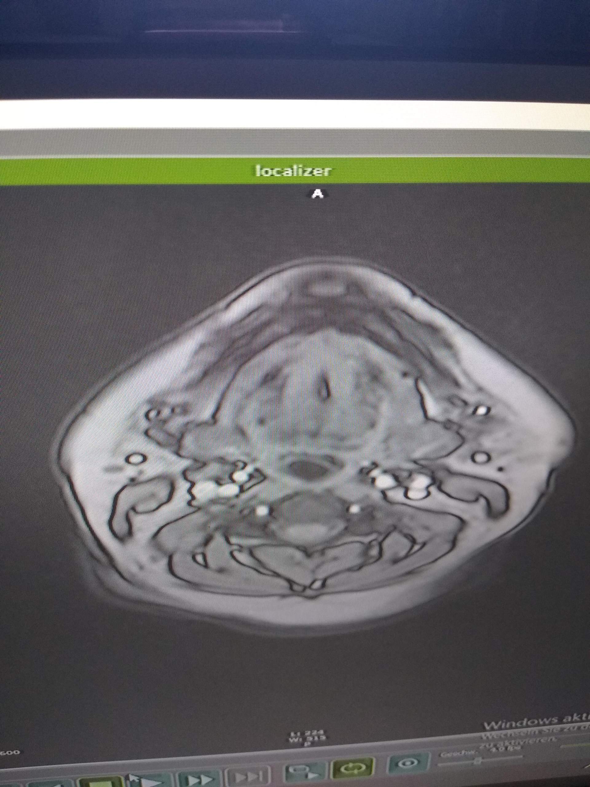 MRT Halsweichteile? (Gesundheit)