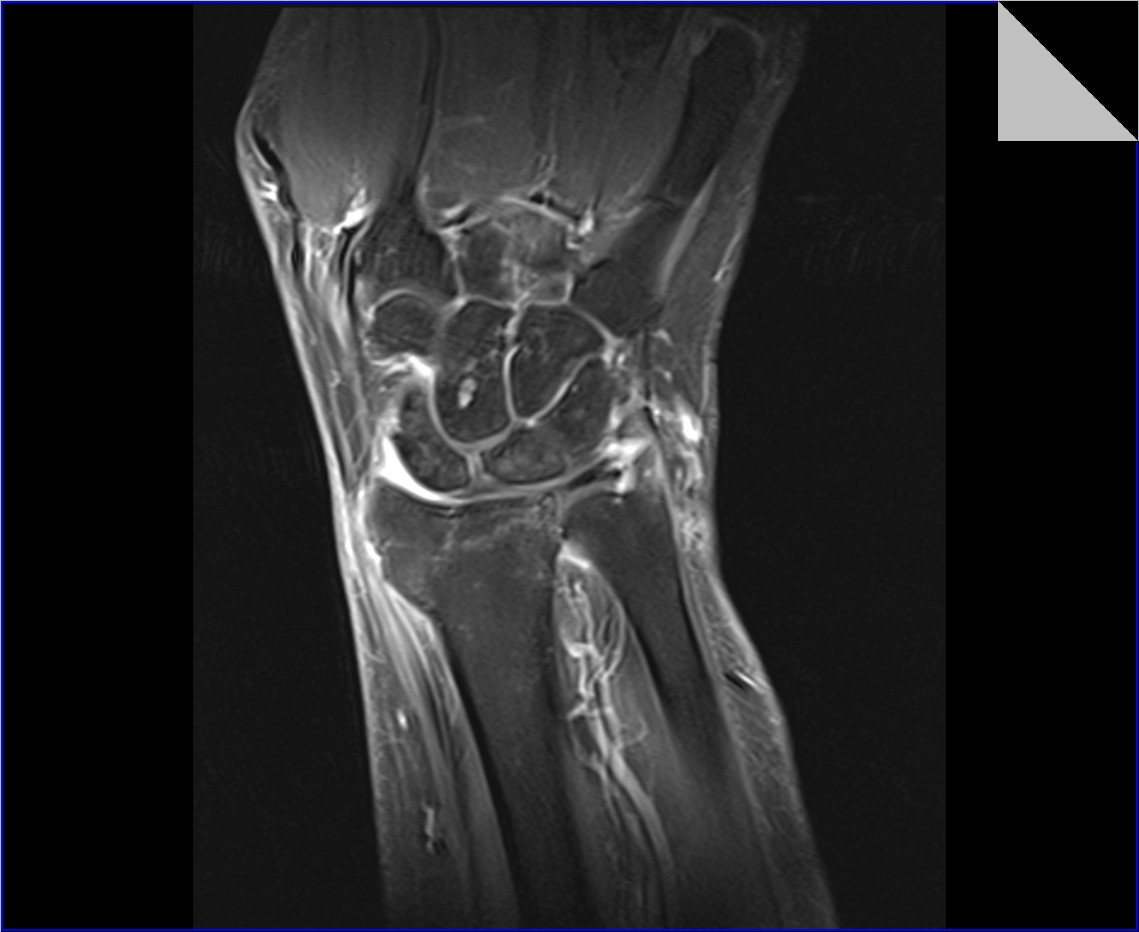 MRT Handgelenk Befund (Hand, radiusfraktur)