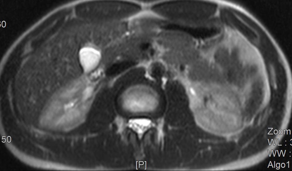 MRT Oberbauch - Gallenblase eingeklemmt? (Medizin, Radiologie)