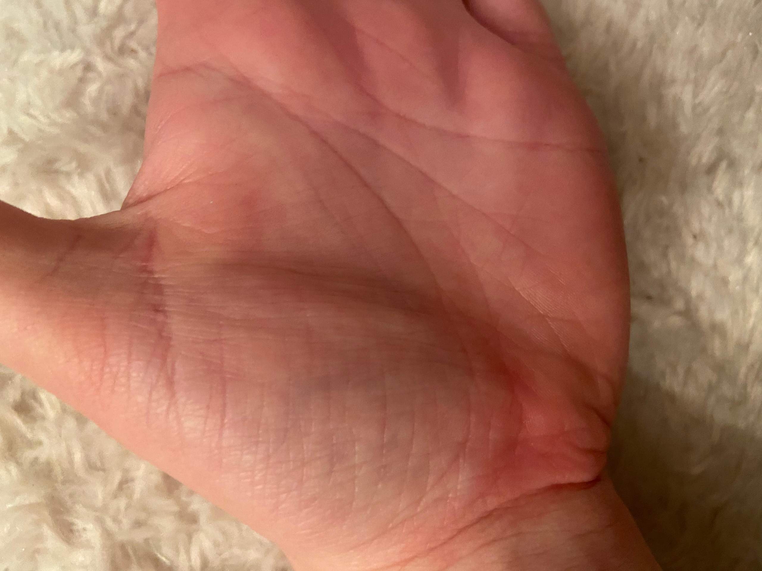 Muskelschwund an den Händen mit FOTO? (Gesundheit und Medizin ...