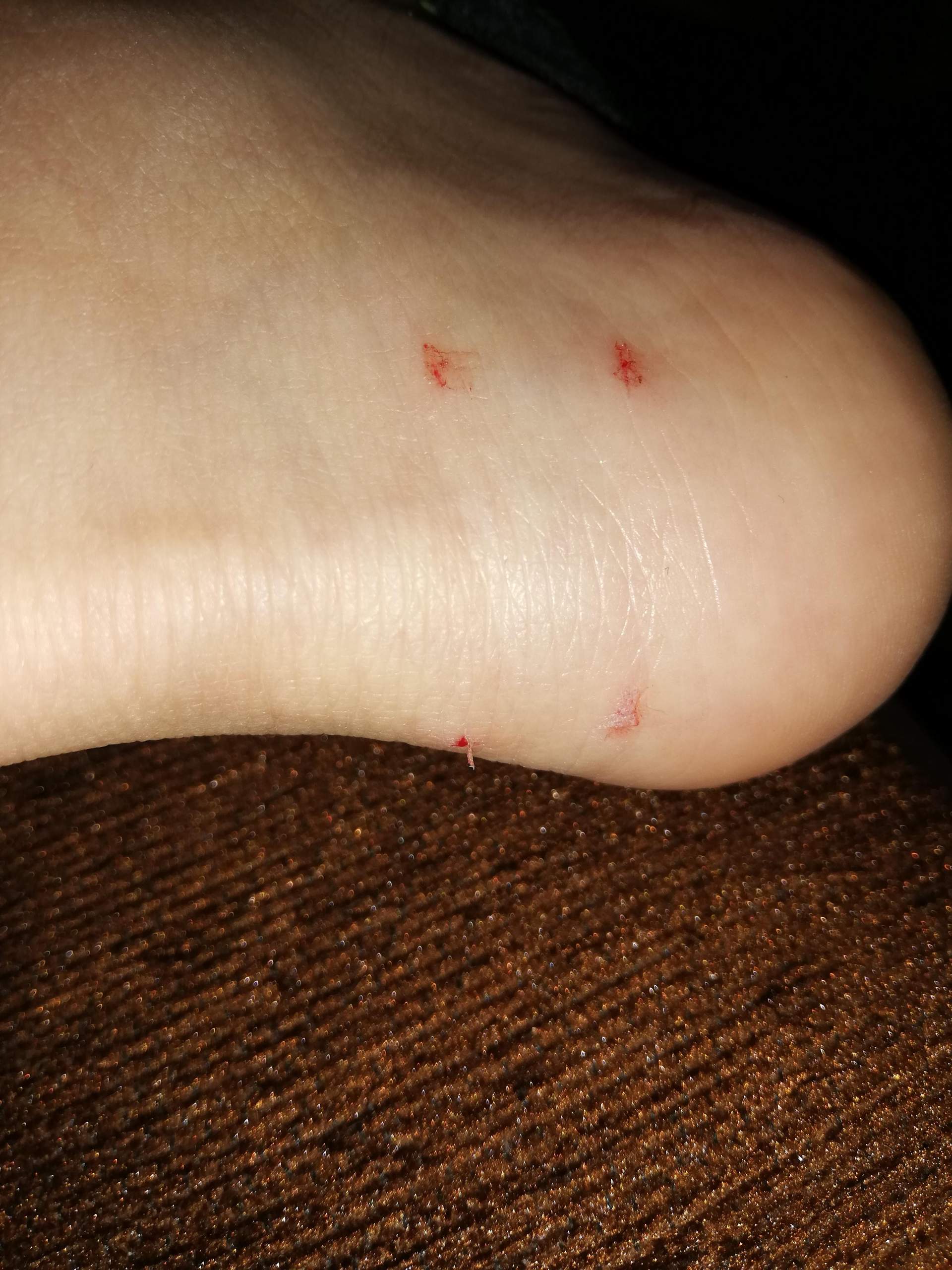 Muss ich mir über diesen Katzenbiss Sorgen machen? (Gesundheit und ...