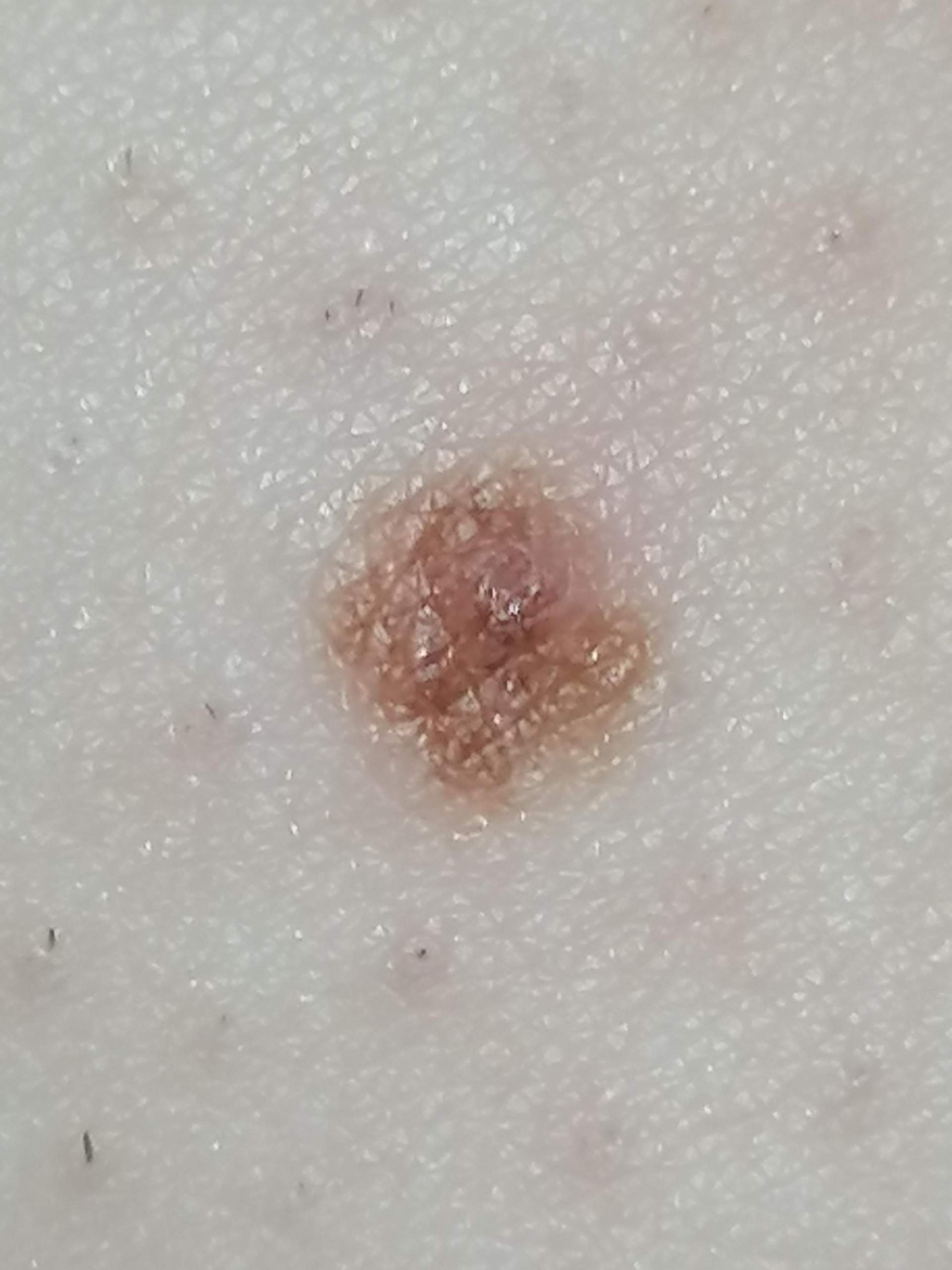 Muttermal? (Gesundheit und Medizin, Liebe und Beziehung, Gesundheit)