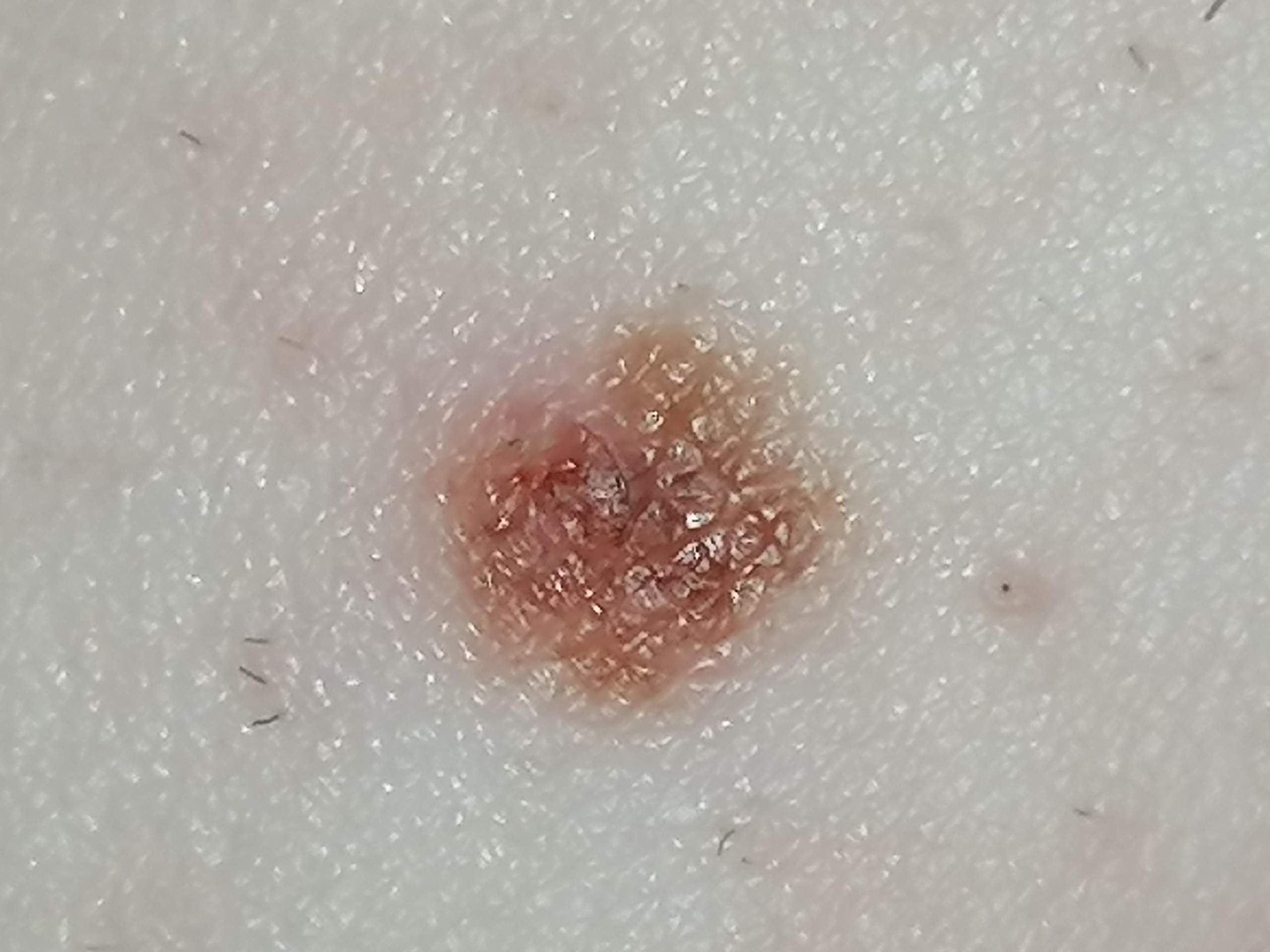 Muttermal? (Gesundheit und Medizin, Liebe und Beziehung, Gesundheit)