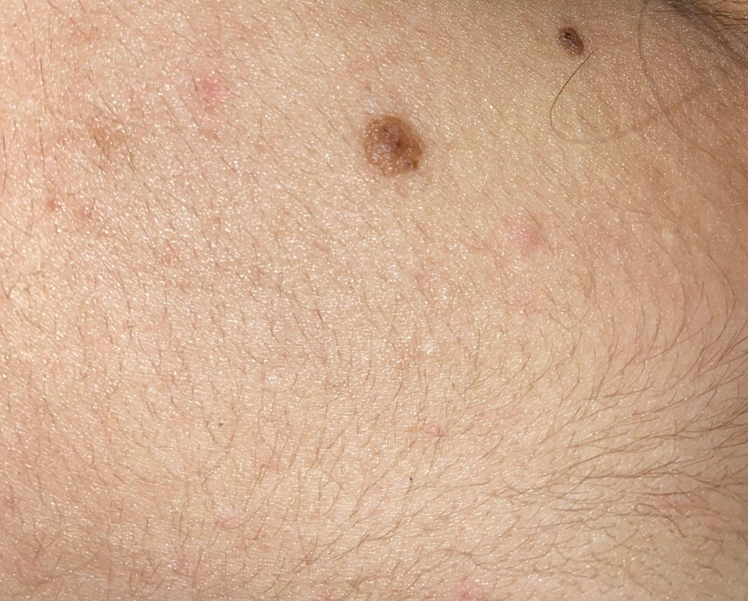 Muttermale gefährlich oder normal? (Gesundheit und Medizin, Gesundheit ...