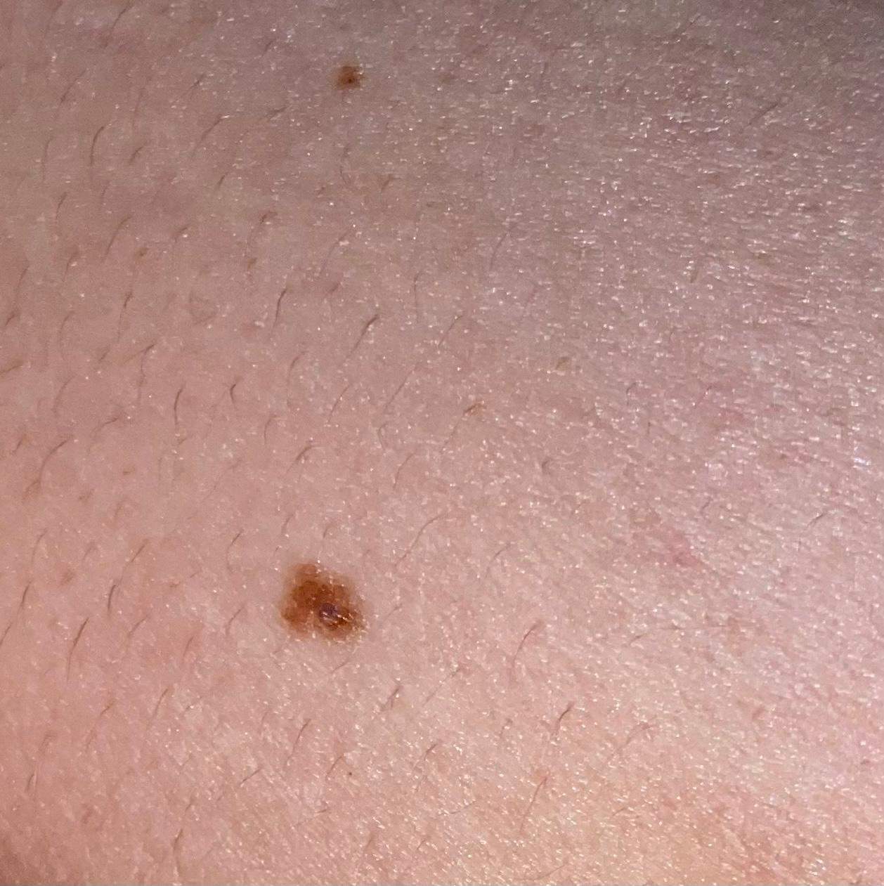 Muttermale gefährlich oder normal? (Gesundheit und Medizin, Gesundheit ...