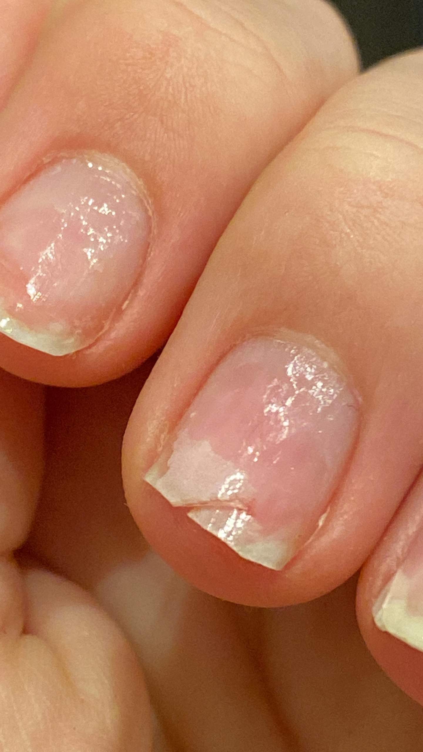 nagel eingeschnitten, was tun? (Schmerzen, Haut, Nägel)