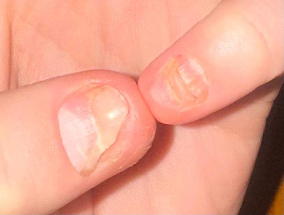 Nagelbett abgerissen, wann wieder Gelnägel? (Mädchen, Kosmetik, Nägel)