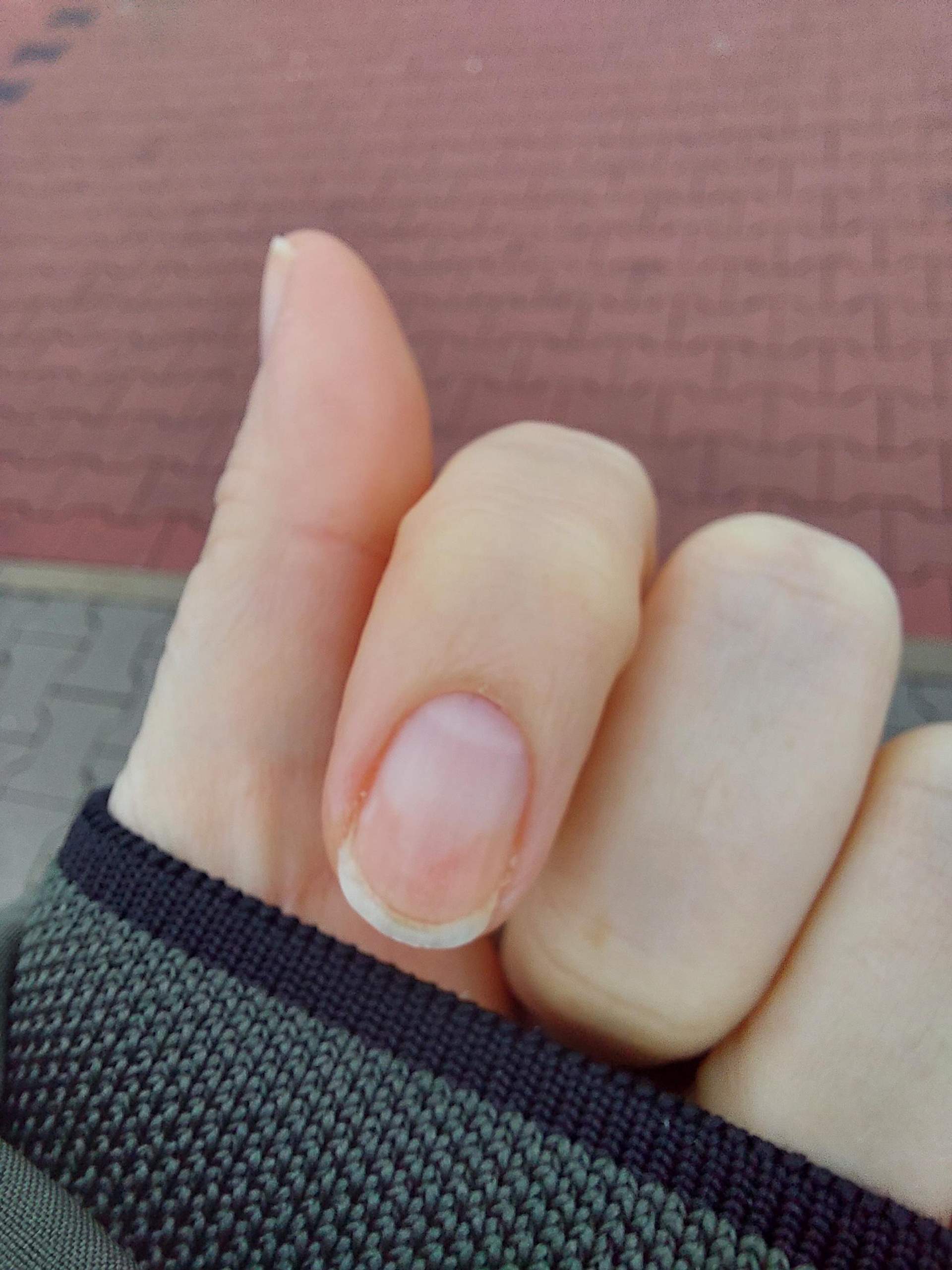 Nagelbett verfärbt? (Nägel, Hand, Finger)