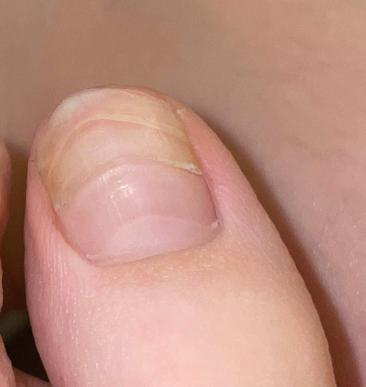 Nagelbrett bricht immer durch, was tun? (Frauen, Körper, Pflege)